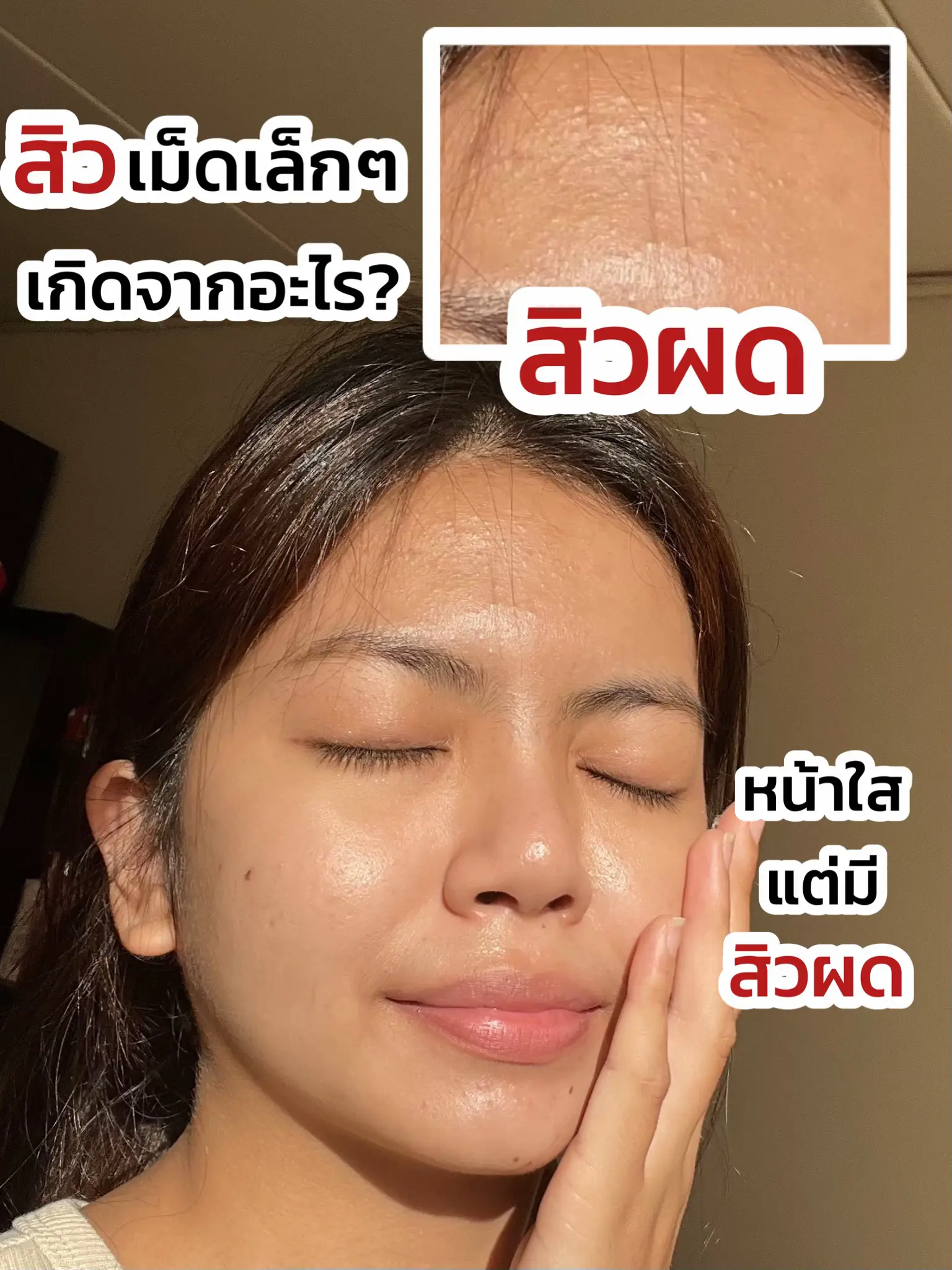 หน้าใสแต่มีสิวผด สิวเม็ดเล็กๆเกิดจากอะไร แกลเลอรีที่โพสต์โดย Kkacha