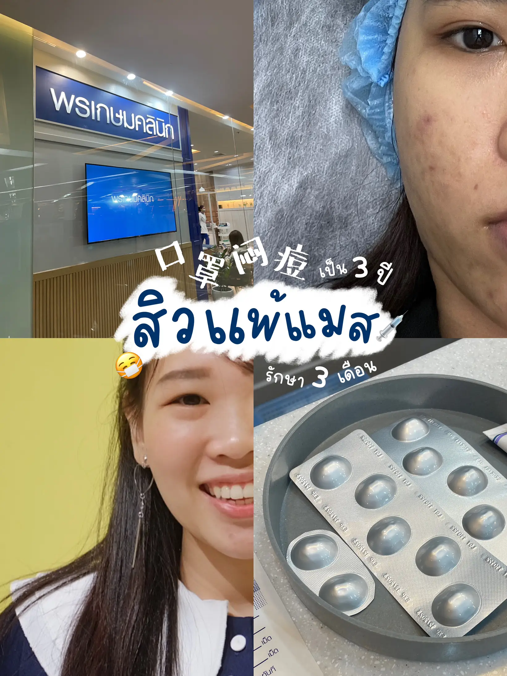 รักษาสิวแพ้แมสกับคลินิกดัง เป็น3ปี รักษา 3 เดือน 😷💉💊 | แกลเลอรีที่โพสต์โดย xiaolifav. 🫶🏻 | Lemon8