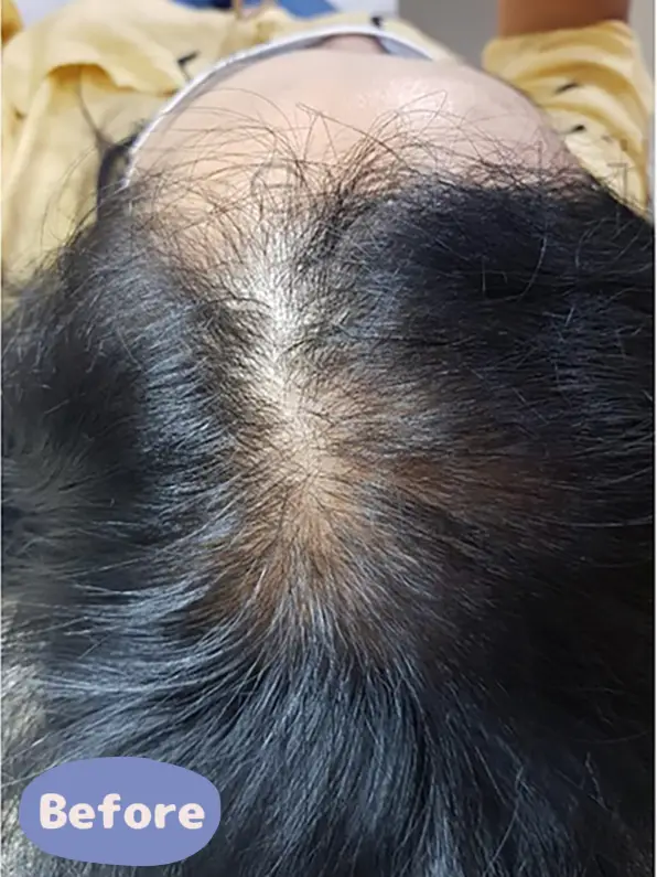 Hasil Nyata!!! Before After PRP Rambut | Galeri diposting oleh Skinfo ...