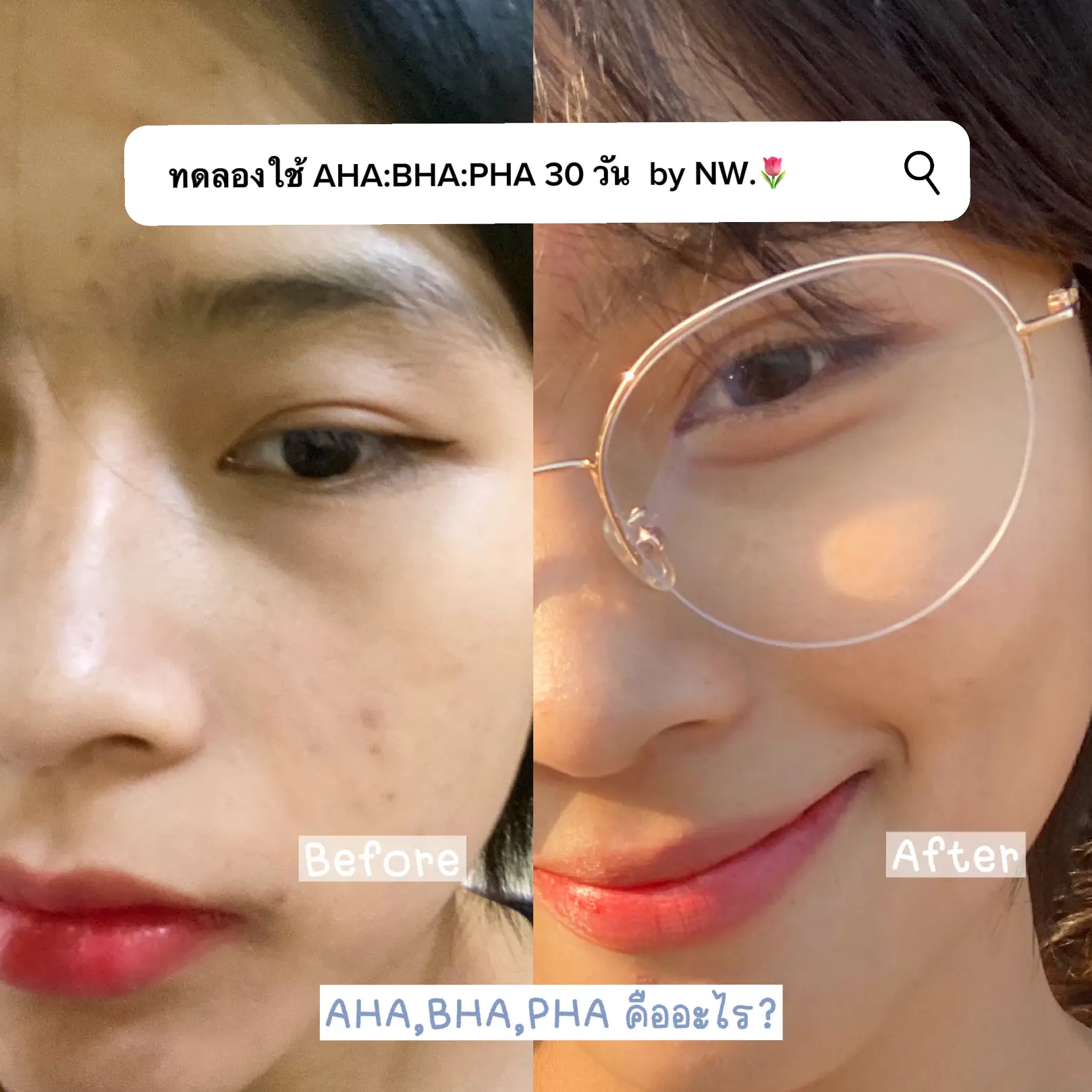 AHA:BHA:PHA ทดลองใข้ติดกัน 30 วัน จะปังเเค่ไหน | แกลเลอรีที่โพสต์โดย namwhan 🍋 | Lemon8