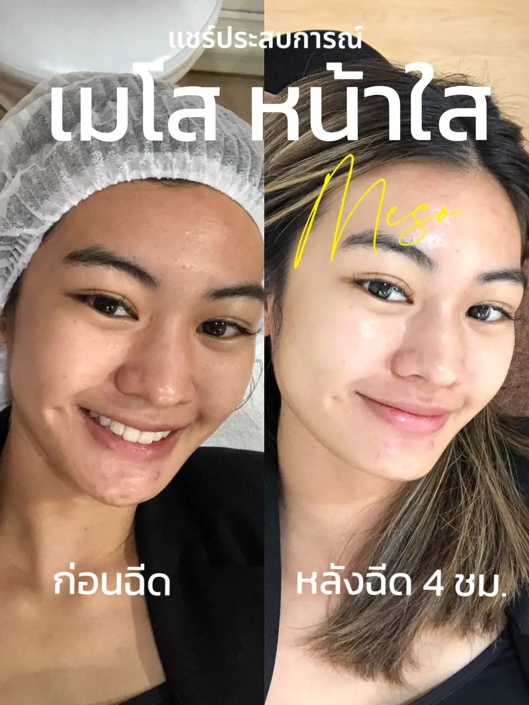 แชร์ประสบการณ์ฉีด meso หน้าใส ไร้สิว ฉบับเร่งด่วน | แกลเลอรีที่โพสต์โดย ...