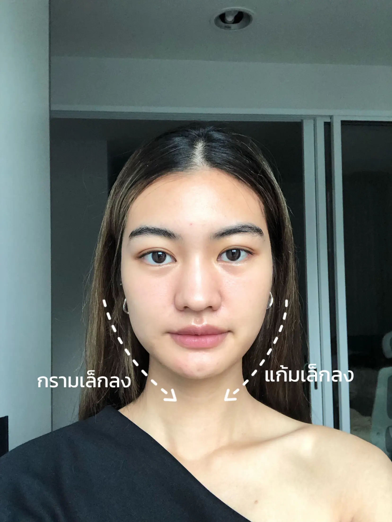 รีวิวฉีดแฟตหน้า การค้นหาใน Lemon8