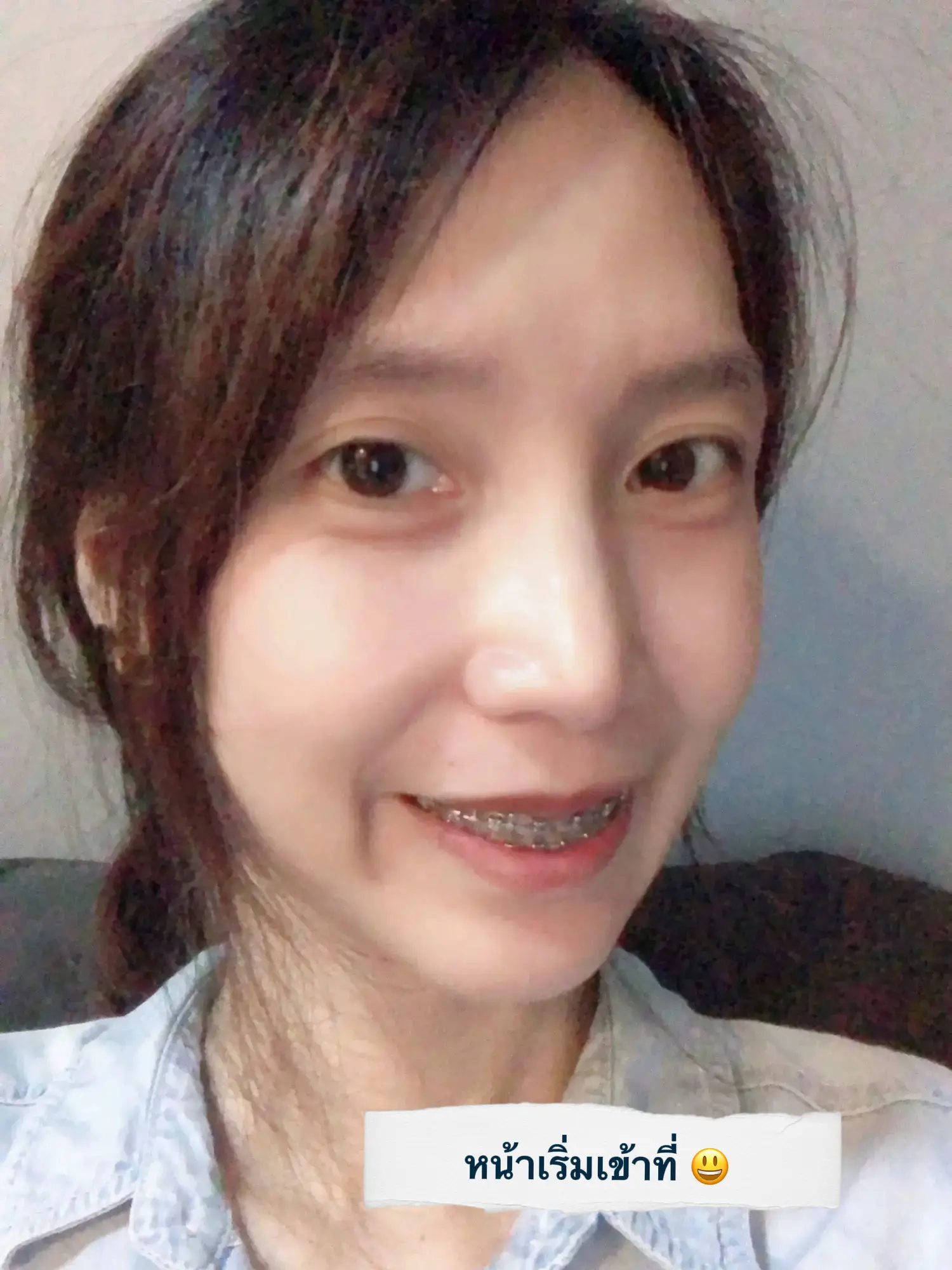 Ep.3 ผ่าตัดขากรรไกร ครบ 2 เดือน มาดูกัน | แกลเลอรีที่โพสต์โดย Hihu | Lemon8