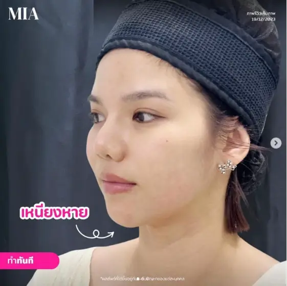 🍁 เหนียงเริ่มออก ให้มาทำ HIFU !! 🍁 | แกลเลอรีที่โพสต์โดย MIA รีวิว | Lemon8