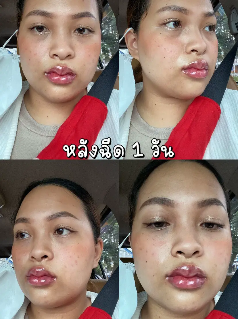 ฉีดฟิลเลอร์ปาก2cc | แกลเลอรีที่โพสต์โดย โมโมรีวิวสาวอวบ | Lemon8