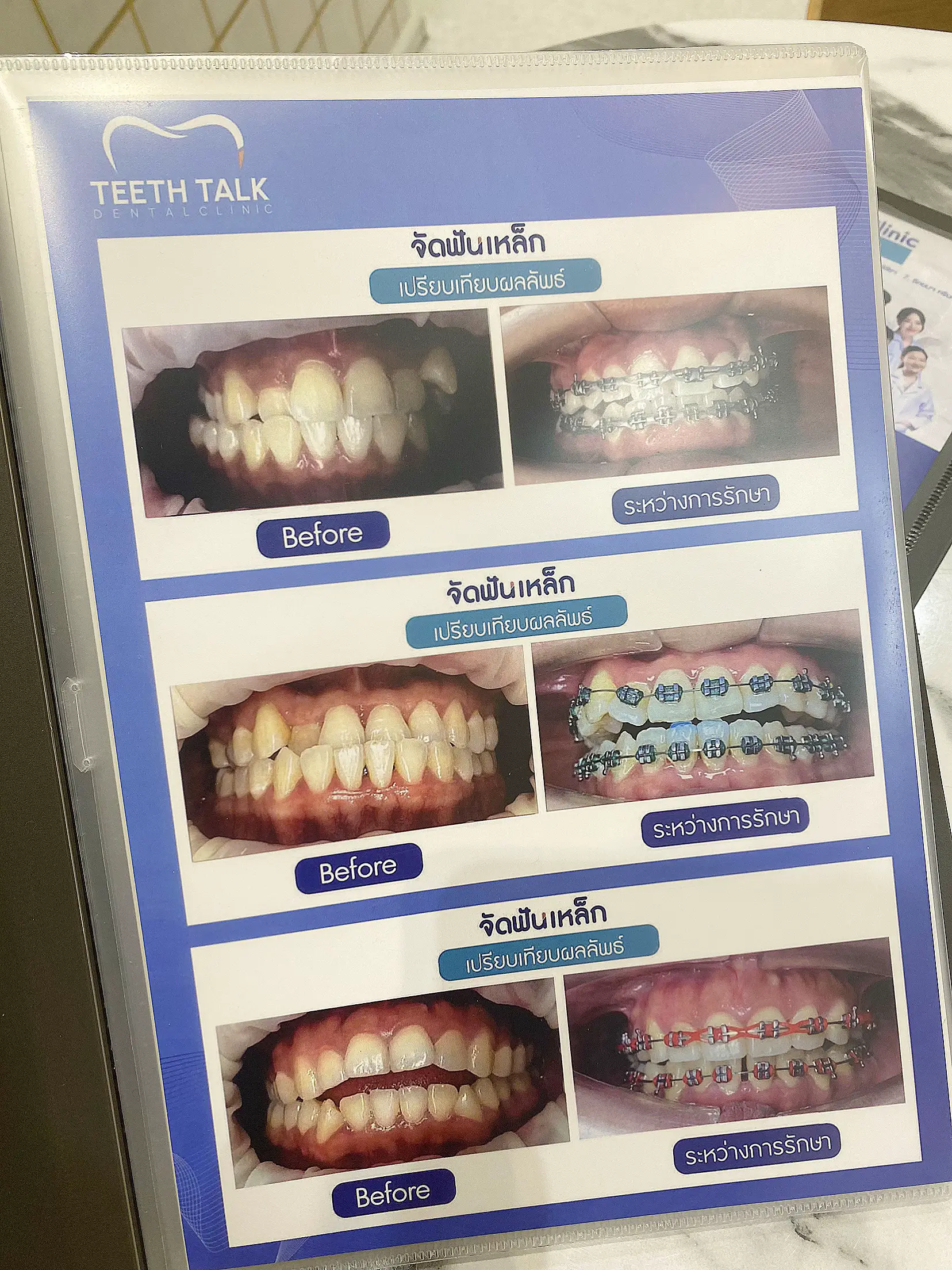 รีวิวจัดฟัน 🦷ที่ TEETH TALK 999- | แกลเลอรีที่โพสต์โดย May SK.14 | Lemon8