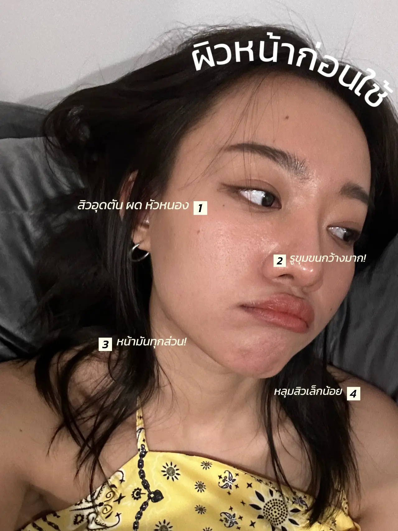 Acnetin a ปังหรือพัง?!! | แกลเลอรีที่โพสต์โดย Mintny | Lemon8