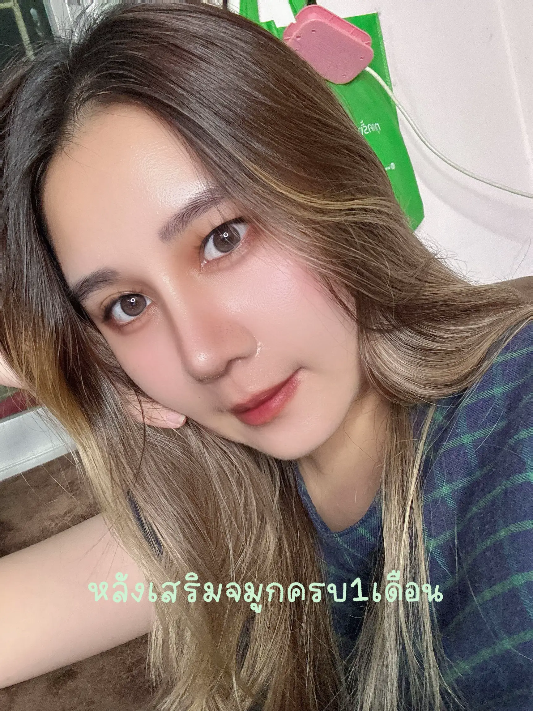 หลังเสริมจมูกครบ1เดือน | แกลเลอรีที่โพสต์โดย MCink PT | Lemon8