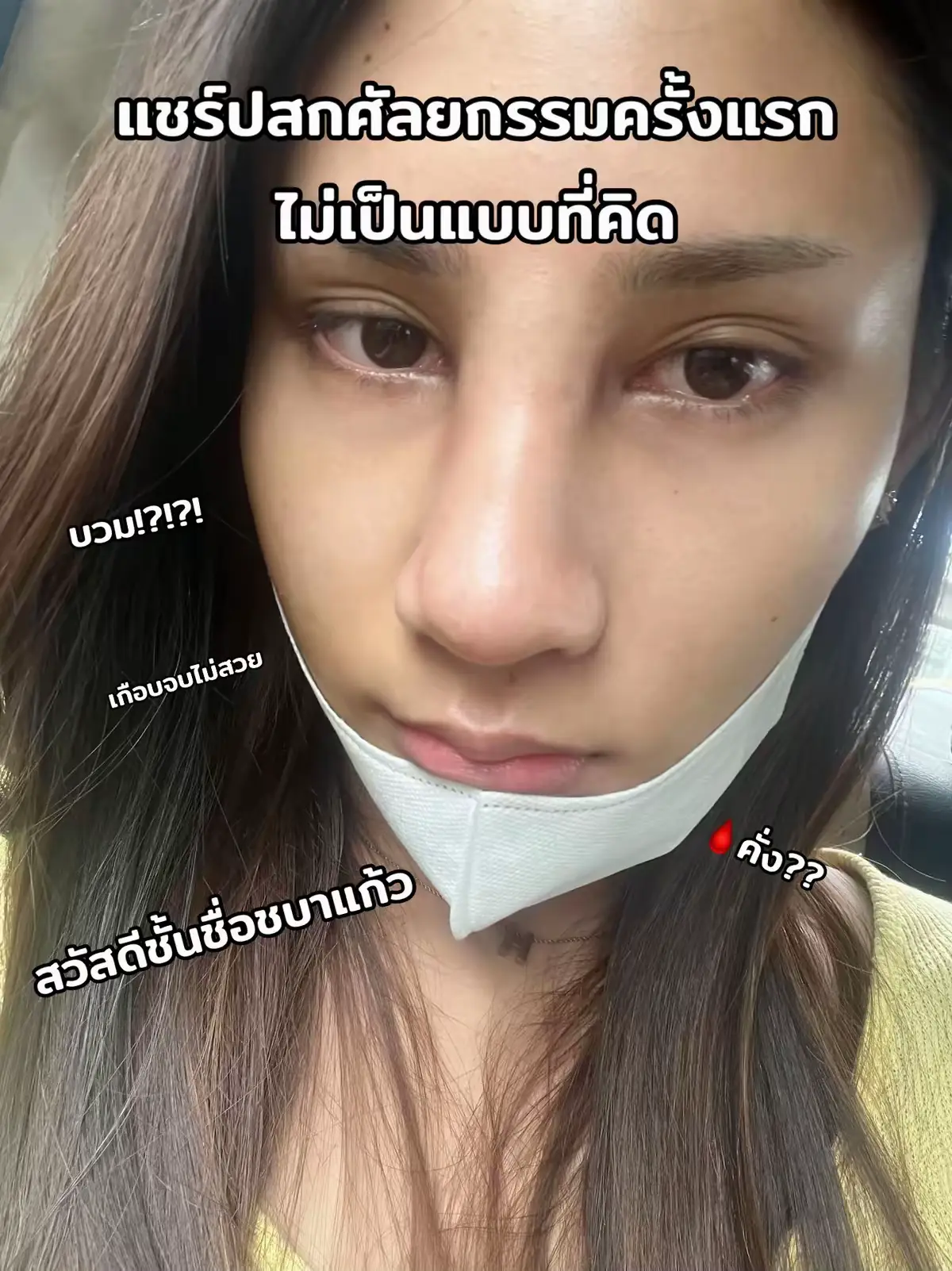 รีวิวประสบการณ์ ทำศัลยกรรมครั้งแรกแต่ไม่เป็นแบบที่คิดด แกลเลอรีที่