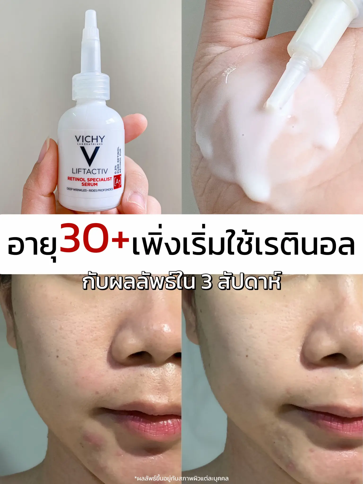 มือใหม่หัดใช้เรตินอลกับผลลัพธ์ที่ได้ | แกลเลอรีที่โพสต์โดย MOREMEWZ | Lemon8
