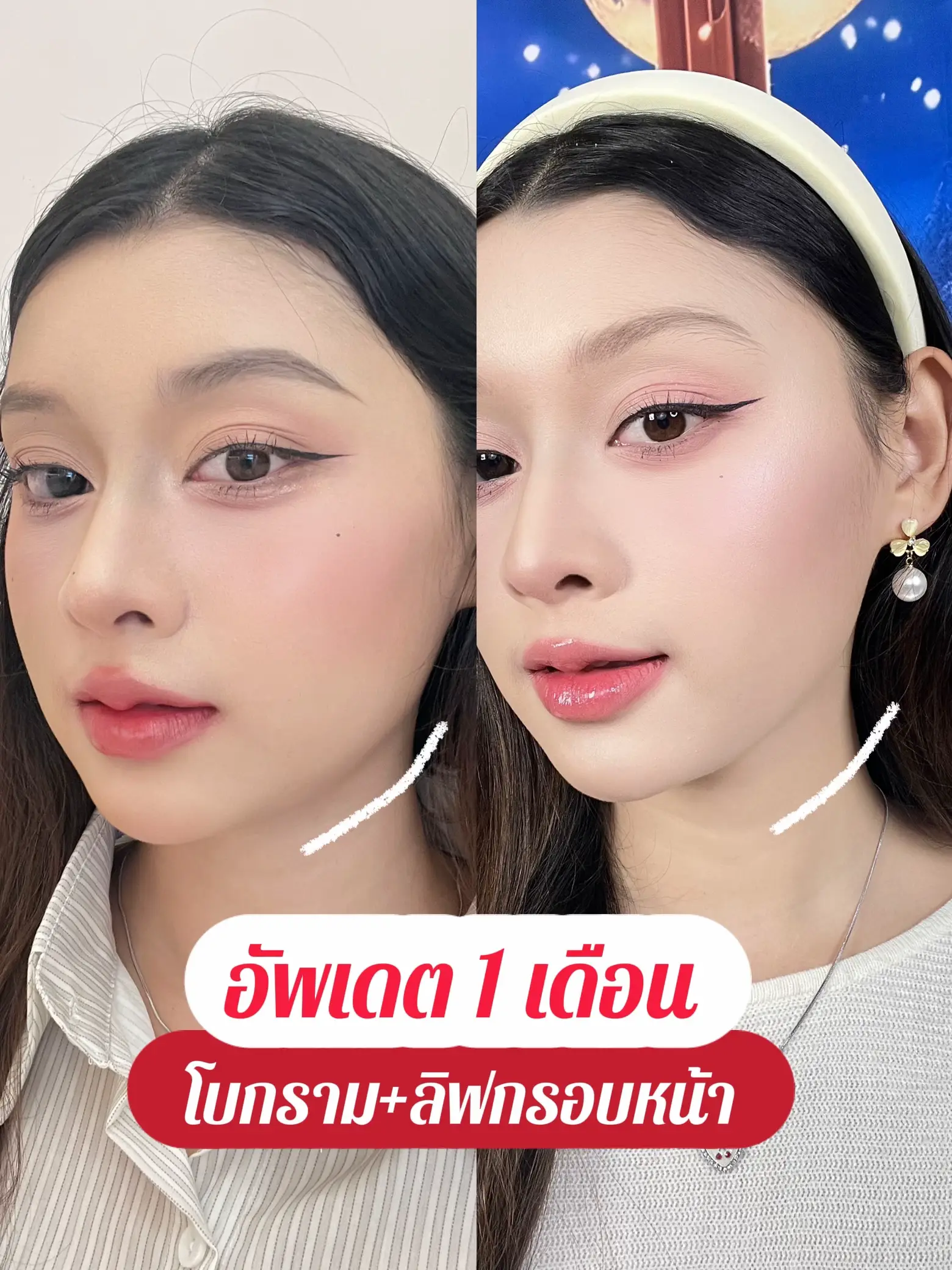 อัพเดต โบกราม+ลิฟกรอบหน้า 1เดือน | แกลเลอรีที่โพสต์โดย Ploypapas41 | Lemon8