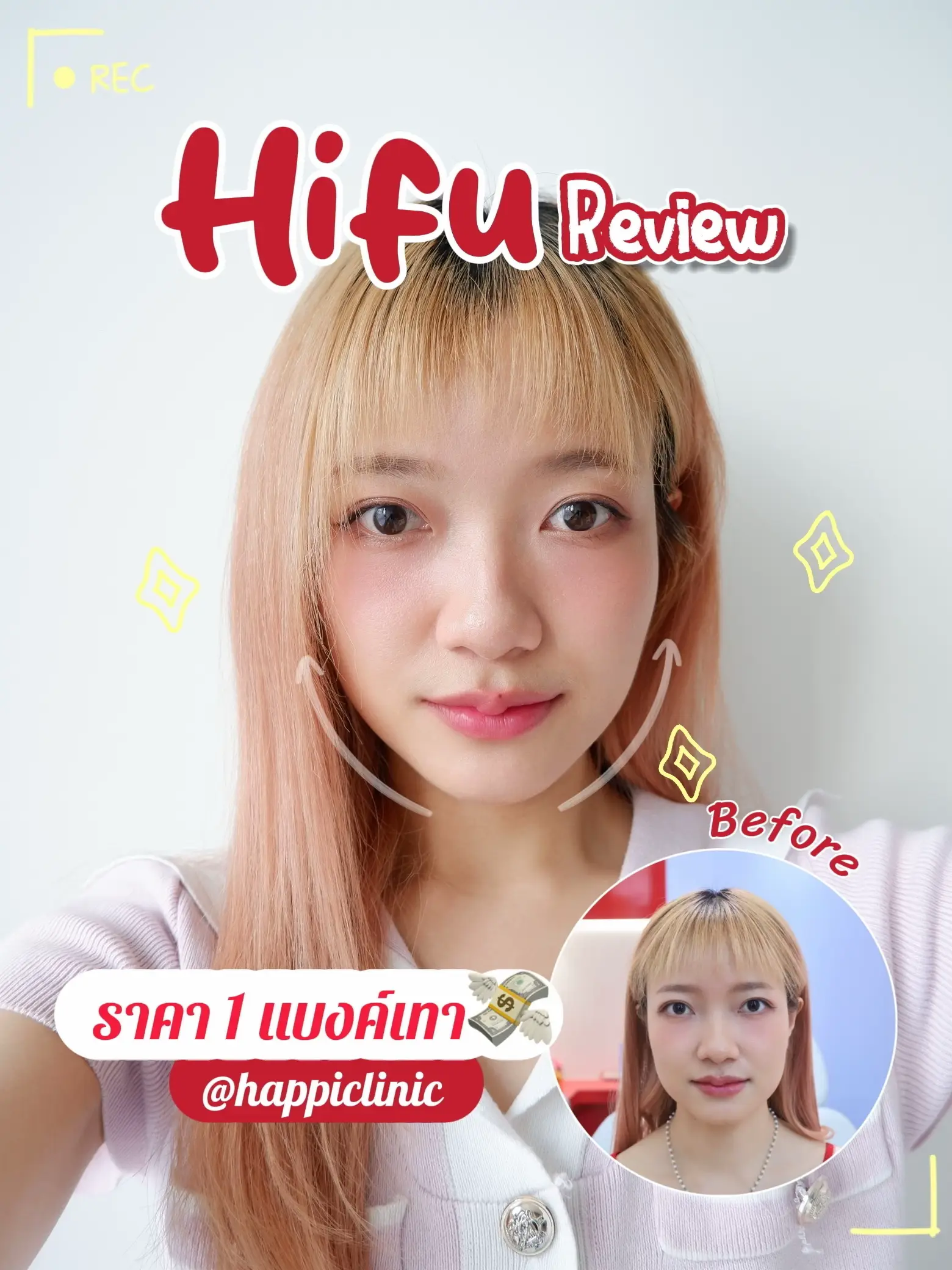 Premium Hifu สองแบ้งค์เทามีทอน เห็นผลจริง😱😱 | แกลเลอรีที่โพสต์โดย ตอเต่าป้ายยา💋👊🏻 | Lemon8