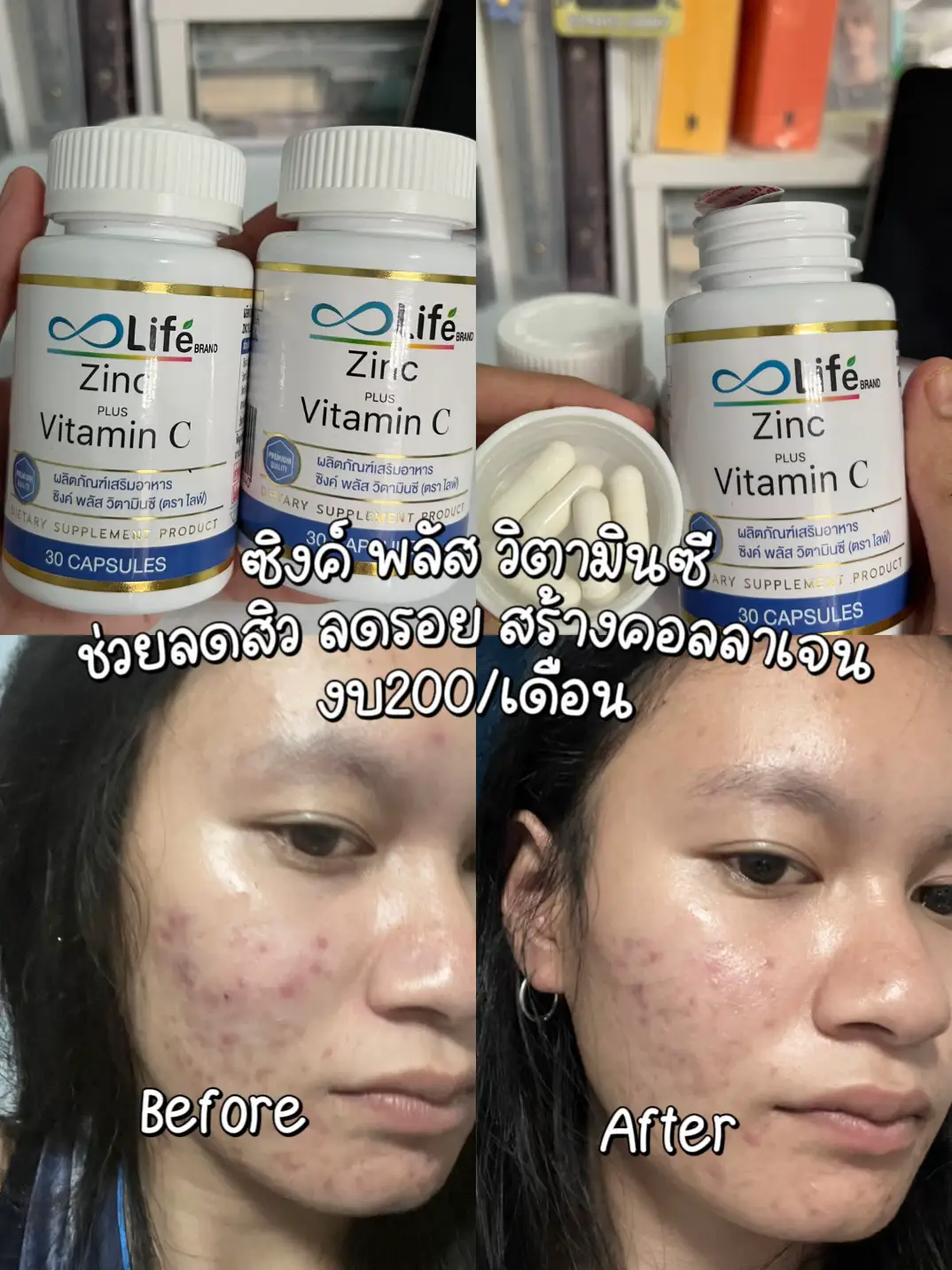 ซิงค์ พลัส วิตามินซีช่วยลดสิว ลดรอย สร้างคอลลาเจน แกลเลอรีที่โพสต์โดย