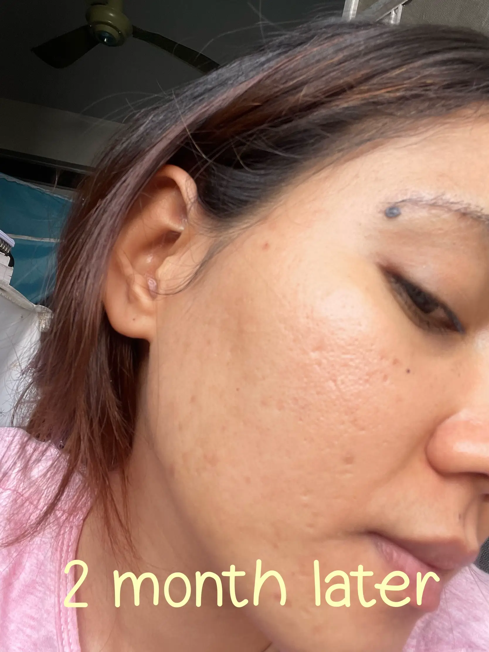 How to รักษาสิวด้วยตัวเองด้วย skincare cycling | แกลเลอรีที่โพสต์โดย Mind Mint | Lemon8