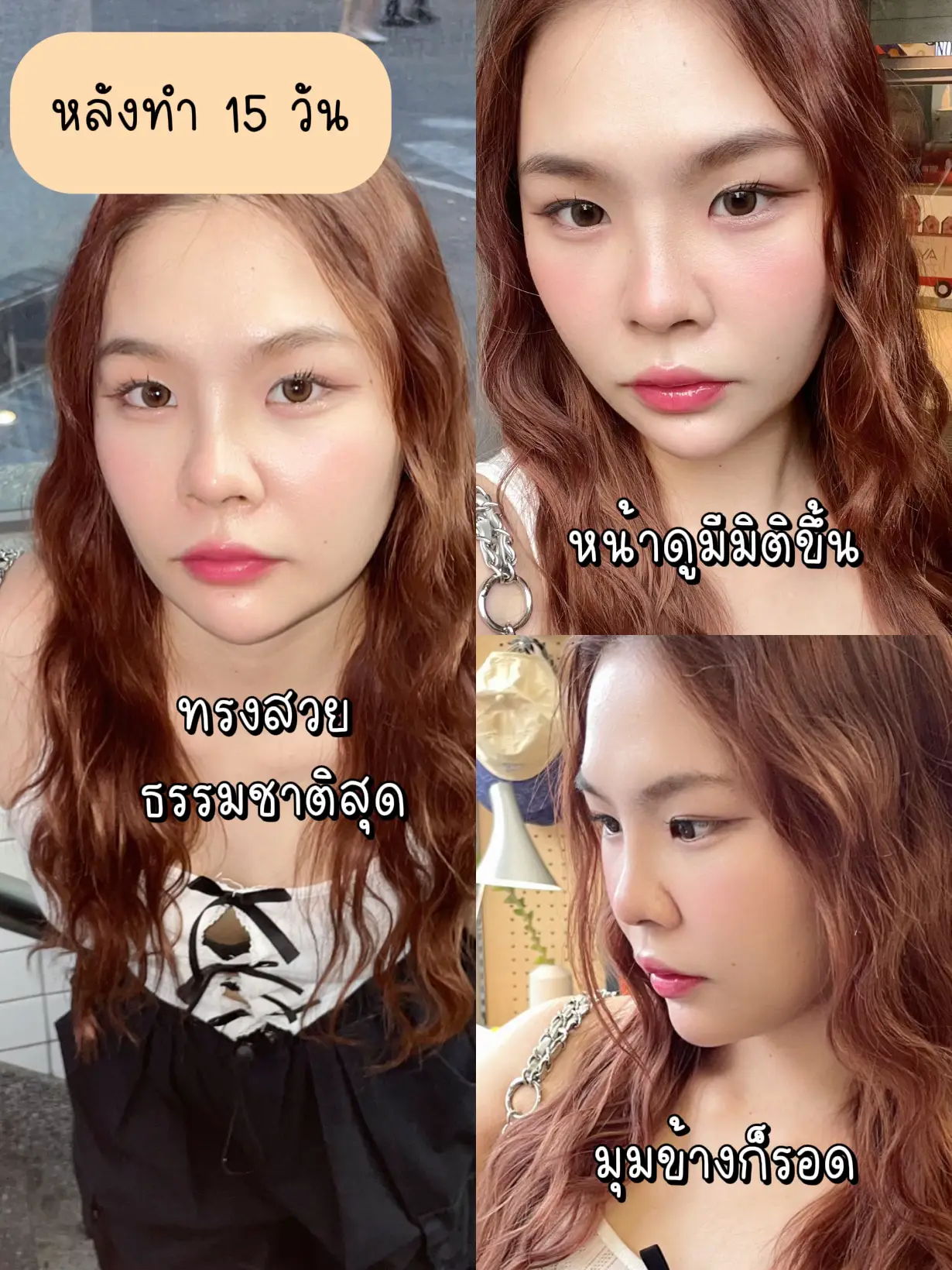 Review | เสริมจมูกครั้งแรกในชีวิต! 👃🏻 | แกลเลอรีที่โพสต์โดย Ployy_pwnii | Lemon8