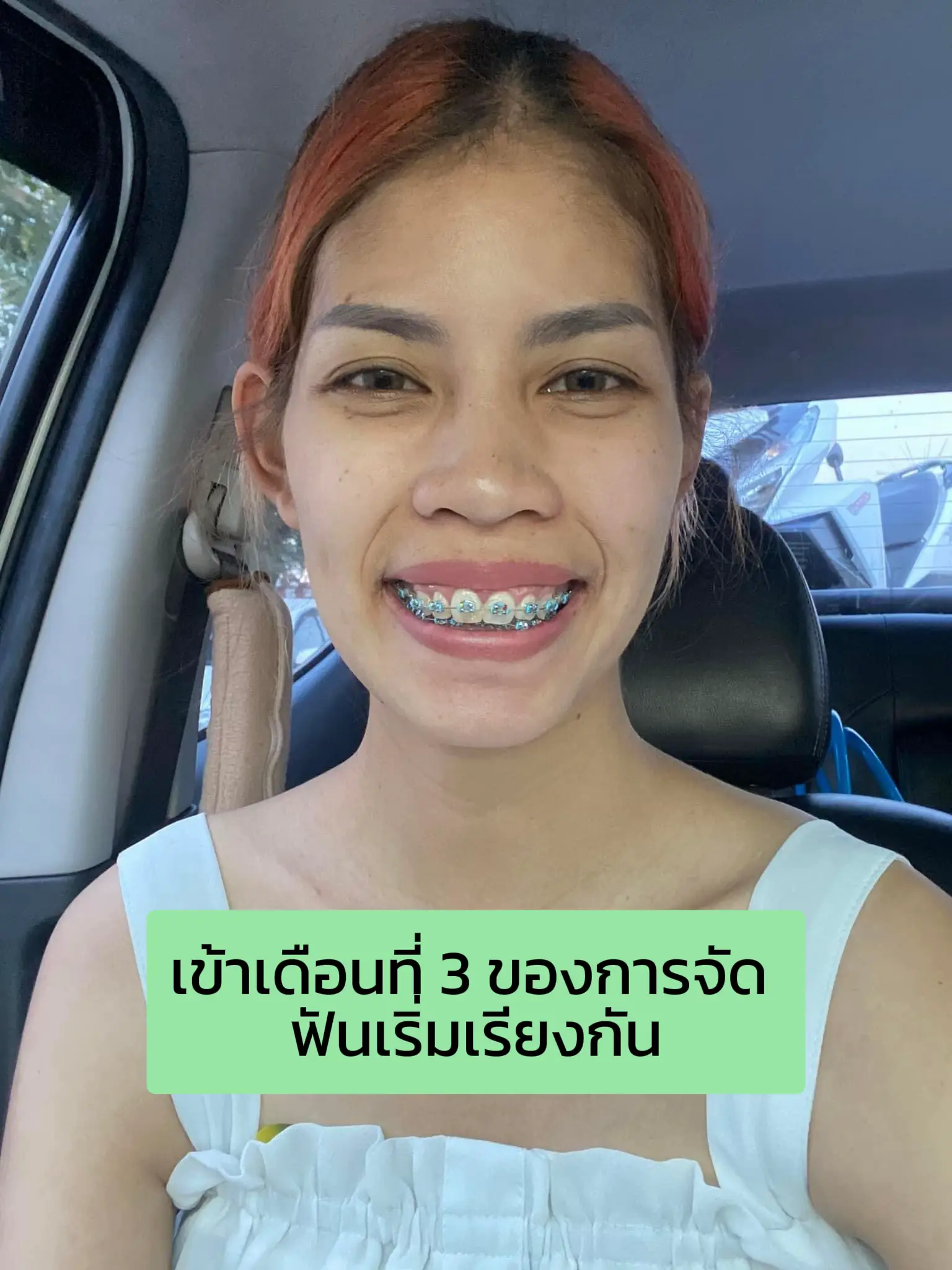 จัดฟันครบ 1 ปีแล้ว มีอะไรเปลี่ยนไปบ้าง? | แกลเลอรีที่โพสต์โดย Ratchaporn Sinm | Lemon8