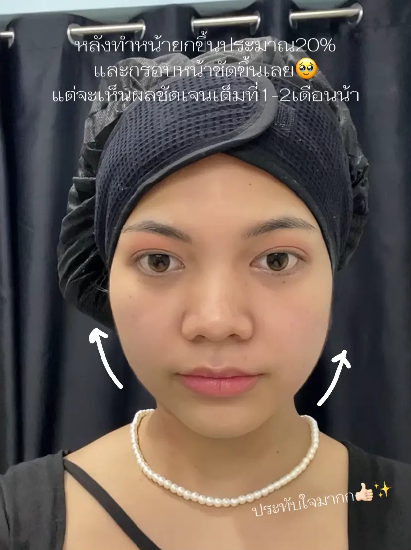 รีวิว HIFU ยกกระชับหน้าที่ Mia Clinic🖐🏻 | แกลเลอรีที่โพสต์โดย superkwann 🎀⭐️ | Lemon8