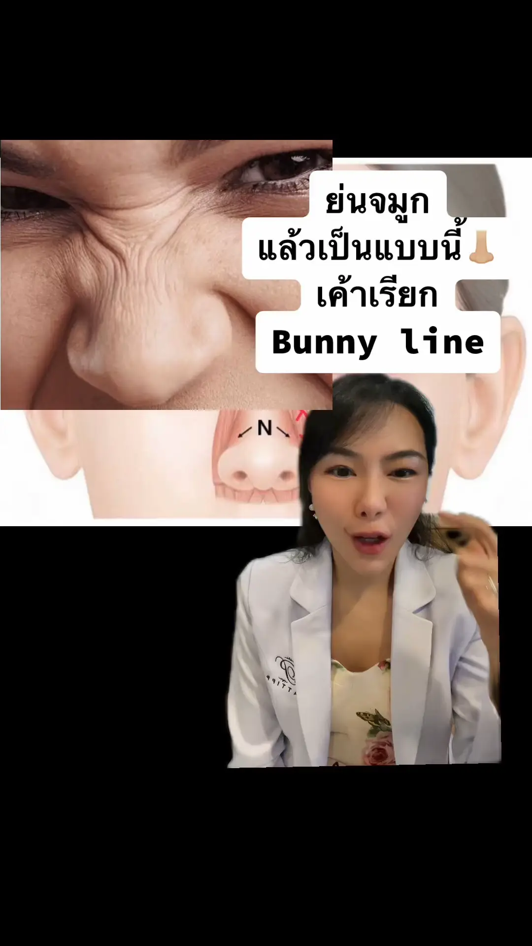 ใครย่น จมูกแล้วเป็นแบบนี้บ้าง?? | วิดีโอที่เผยแพร่โดย DoctorPattippa | Lemon8