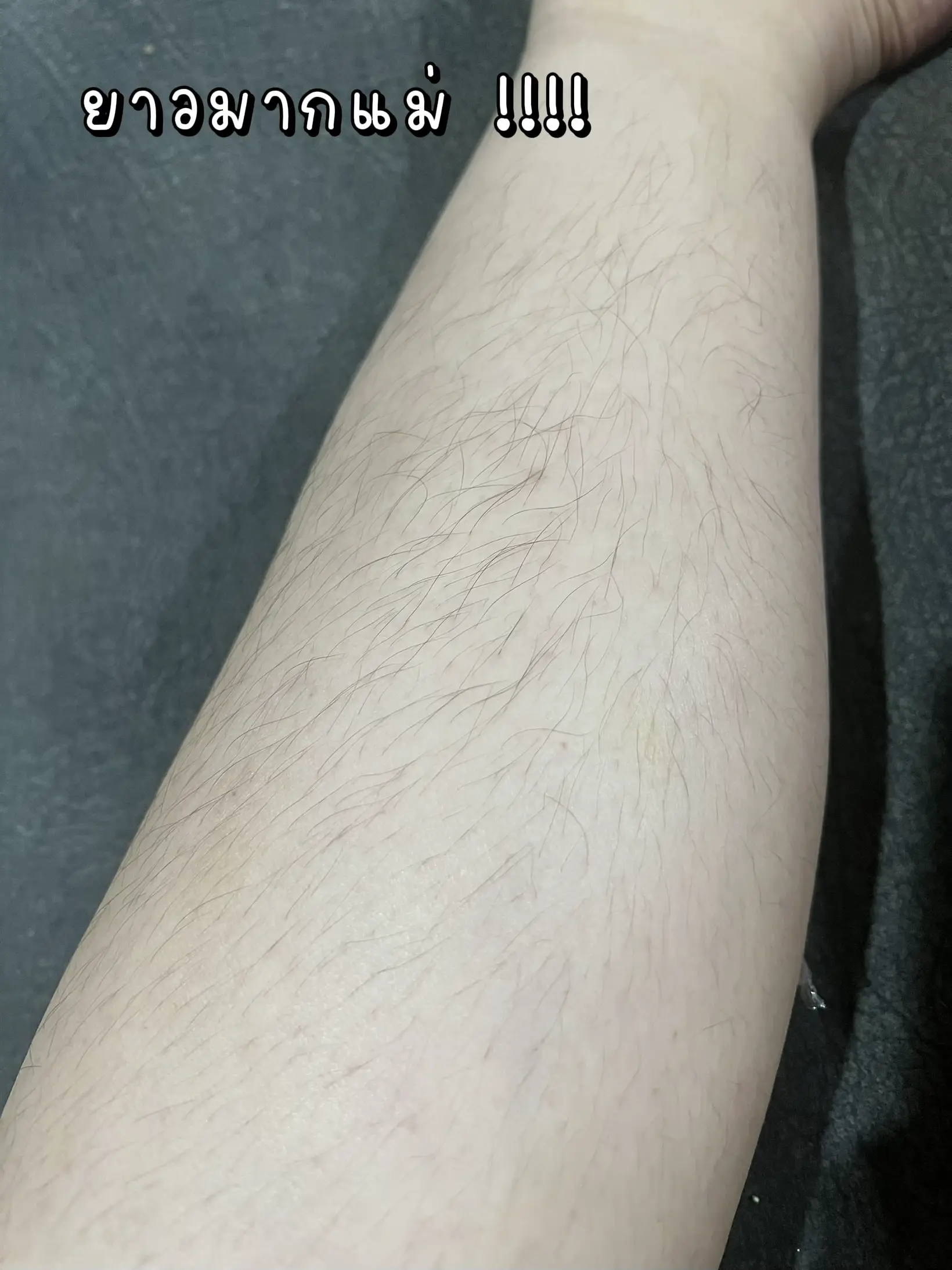 เลเซอร์กำจัดขนด้วยตัวเอง เห็นผลจริงหรือป่าว ? | แกลเลอรีที่โพสต์โดย ...