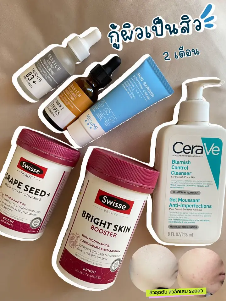 กู้ผิวเป็นสิว ผิวใส ฉบับผิวแพ้ง่าย | แกลเลอรีที่โพสต์โดย Cookiee | Lemon8