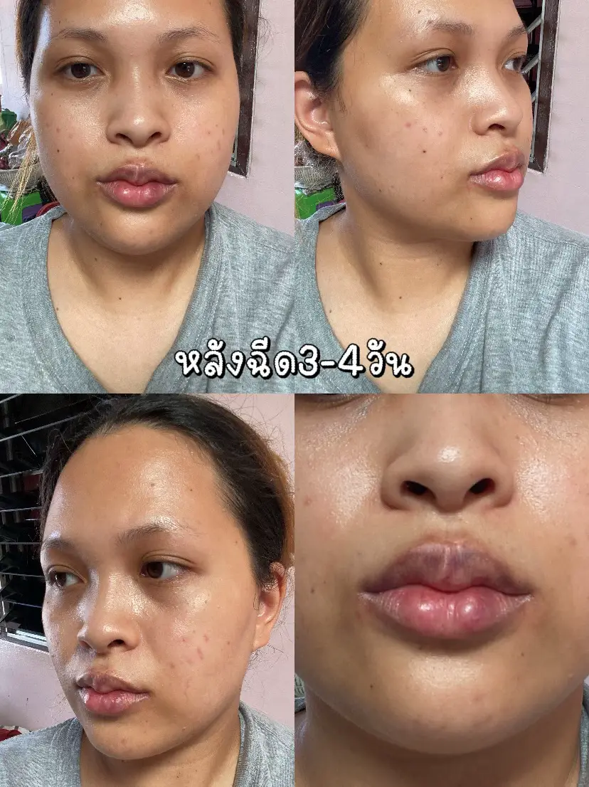 ฉีดฟิลเลอร์ปาก2cc | แกลเลอรีที่โพสต์โดย โมโมรีวิวสาวอวบ | Lemon8