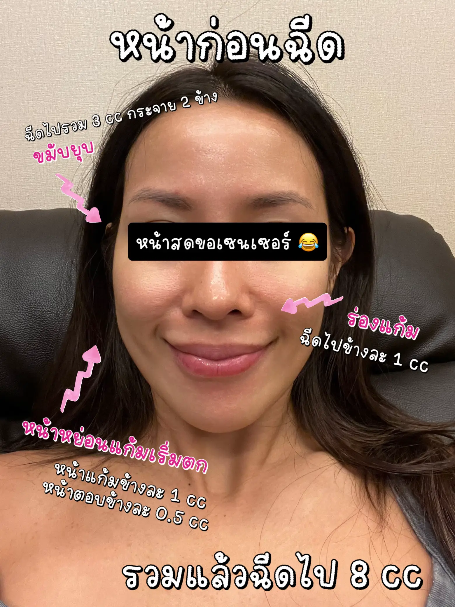 🚨ฉีดฟิลเลอร์หน้าเบี้ยว จนต้องฉีดสลาย 😩 แกลเลอรีที่โพสต์โดย Nan แนนแน๊น •ᴗ• Lemon8