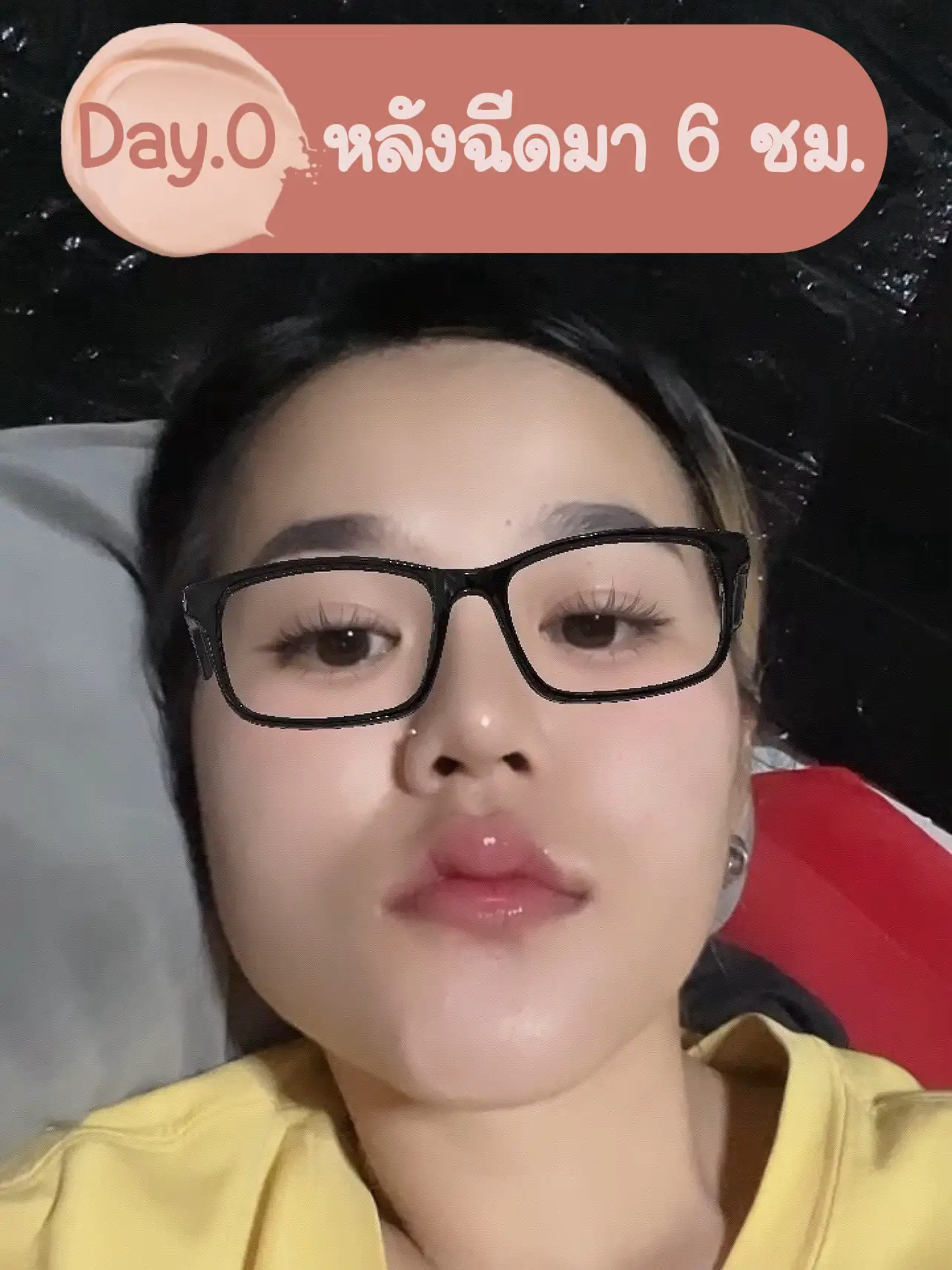 รู้ไงไม่เท่ารู้งี้..ฉีดนานแย้ววววว💉💋🤭 | แกลเลอรีที่โพสต์โดย Daonuea.11 | Lemon8