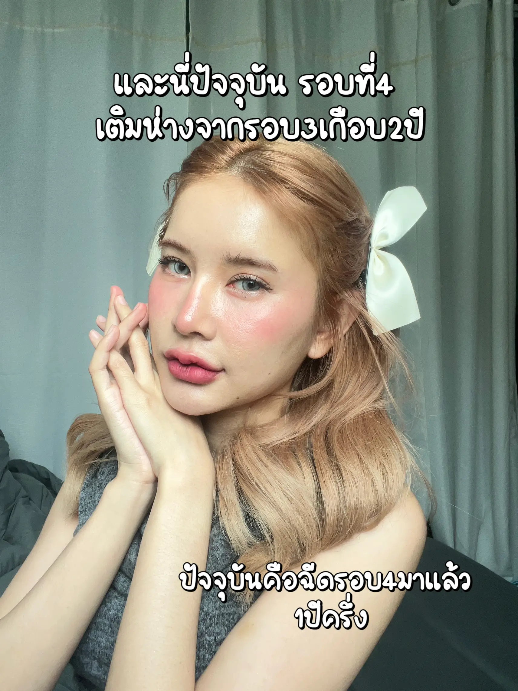 ฟิลเลอร์ปาก สวยจึ้ง ที่ classy clinic | แกลเลอรีที่โพสต์โดย Preempearploy | Lemon8