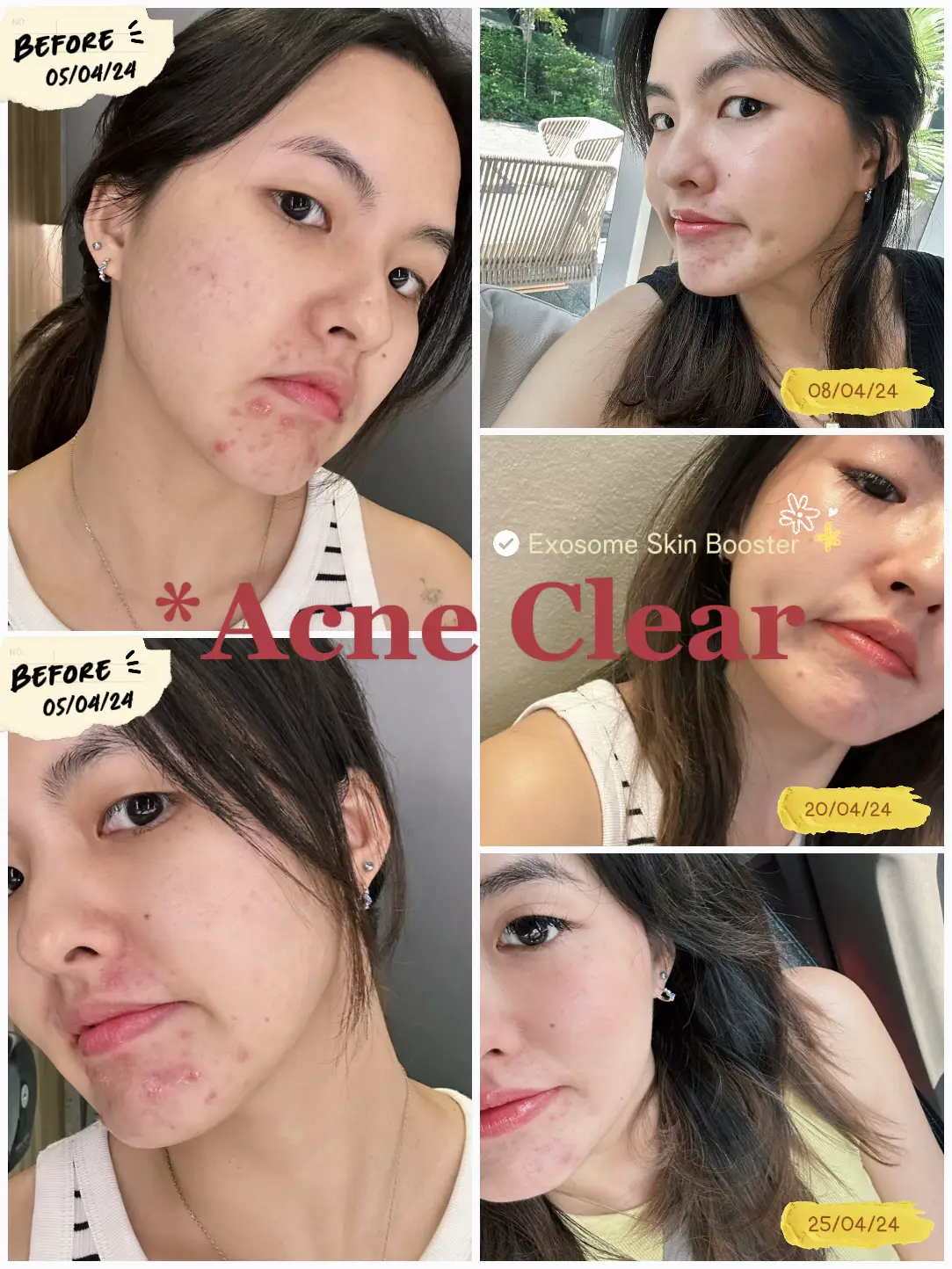 *Acne Clear พลีชีพหน้าสด รักษาสิว 🫣 | แกลเลอรีที่โพสต์โดย smine .pns ...