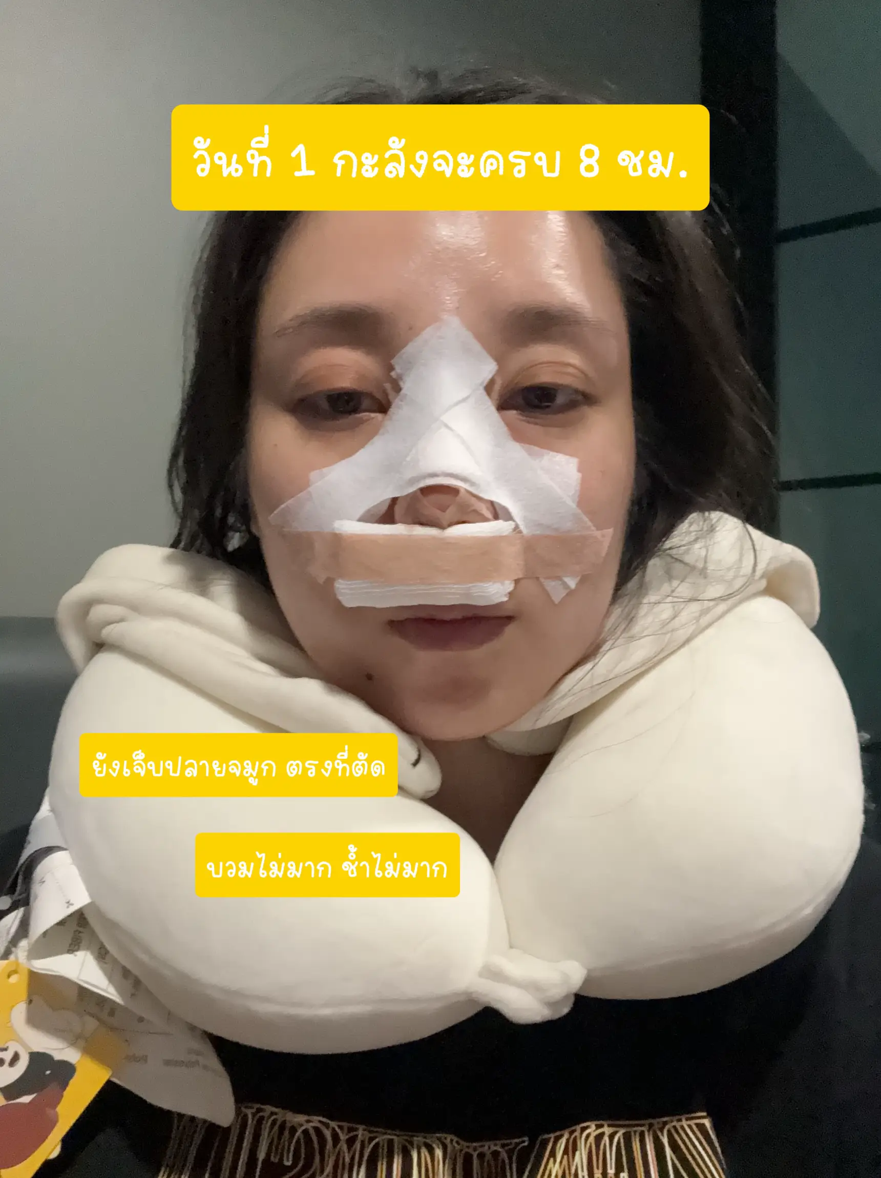 พรีชีพ ครั้งแรก เสริมจมูก full open+กระดูกหลังหู no spon | แกลเลอรีที่ ...