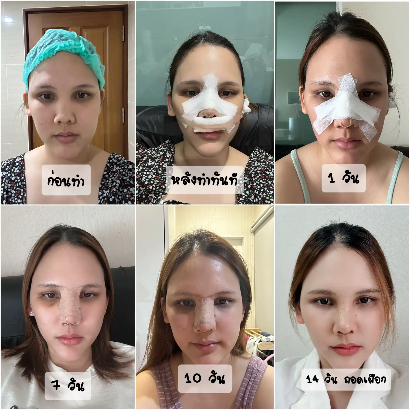 สันจมูกใหญ่👃🏻ทำจมูกแท่งแรก งบ