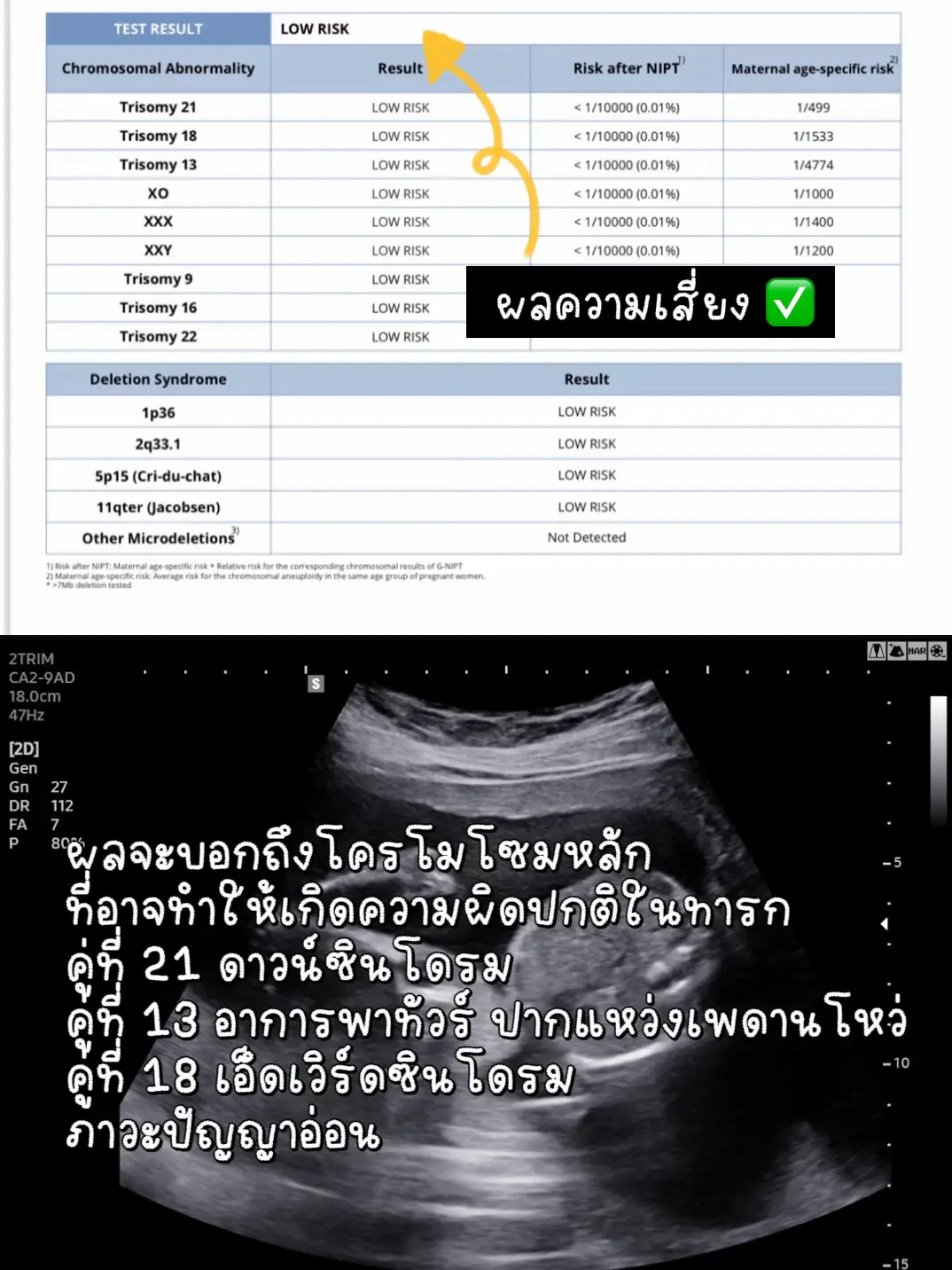 Q&A ตรวจคัดกรองโครโมโซม (NIPT) | แกลเลอรีที่โพสต์โดย Happy Luke 🦒 | Lemon8