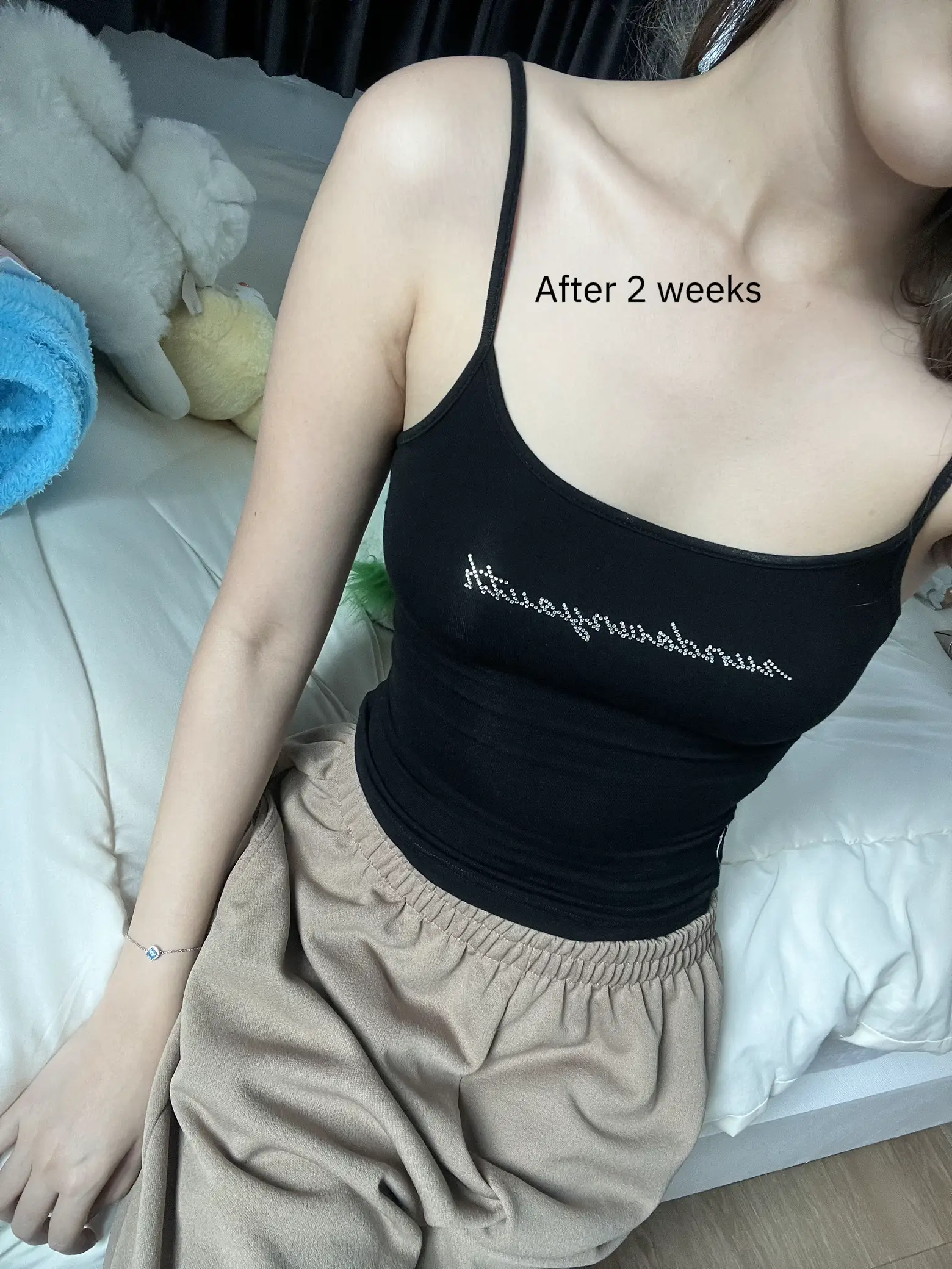 รีวิวฉีดแฟตแขนครั้งแรกเป็นยังไง 💗☁️ | แกลเลอรีที่โพสต์โดย aomphak | Lemon8