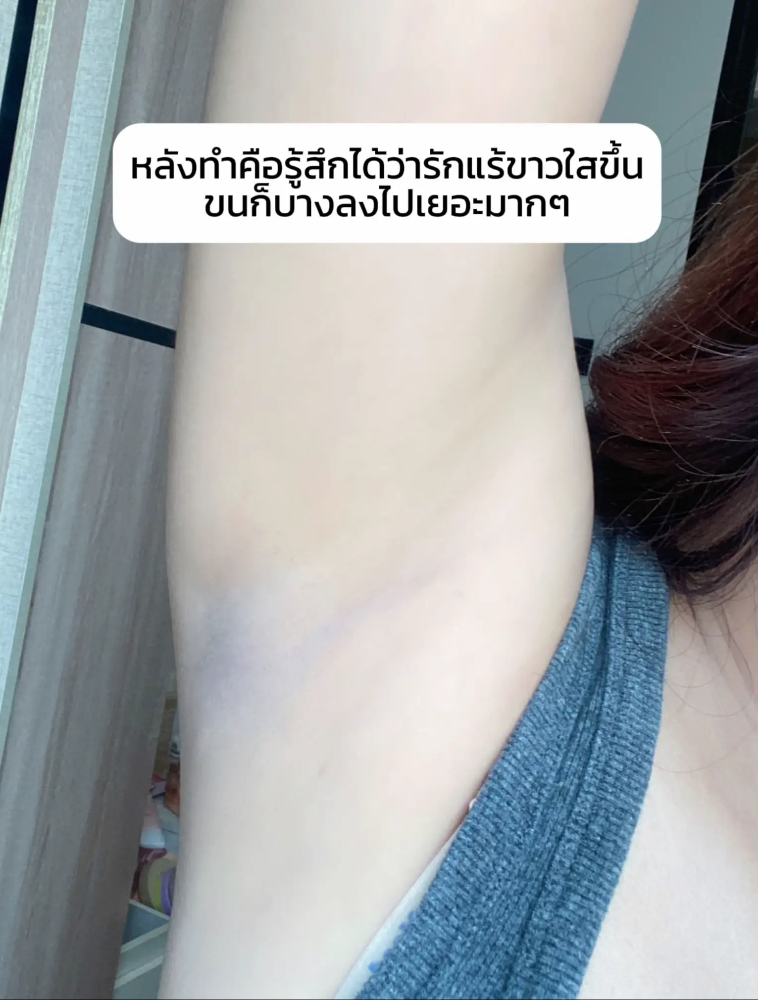 ลองเลเซอร์ขนรักแร้แบบถาวรดีจริงมั้ย ?? | แกลเลอรีที่โพสต์โดย aomreview | Lemon8