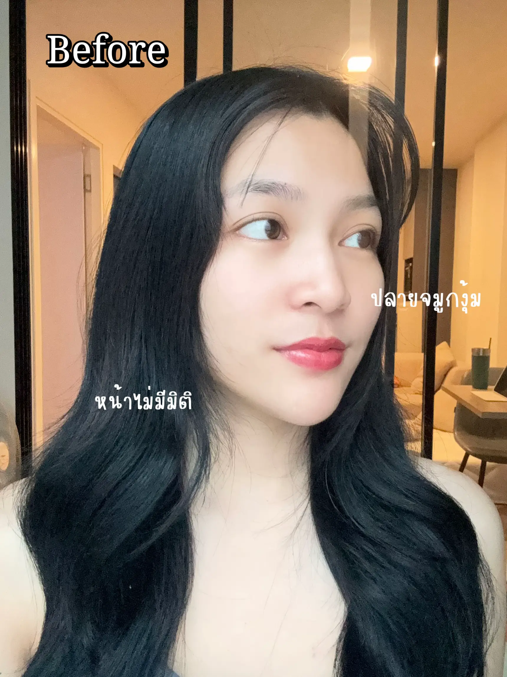 เสริมจมูกครั้งแรกที่ Emma Clinic 💖 | แกลเลอรีที่โพสต์โดย minemint🐰 | Lemon8