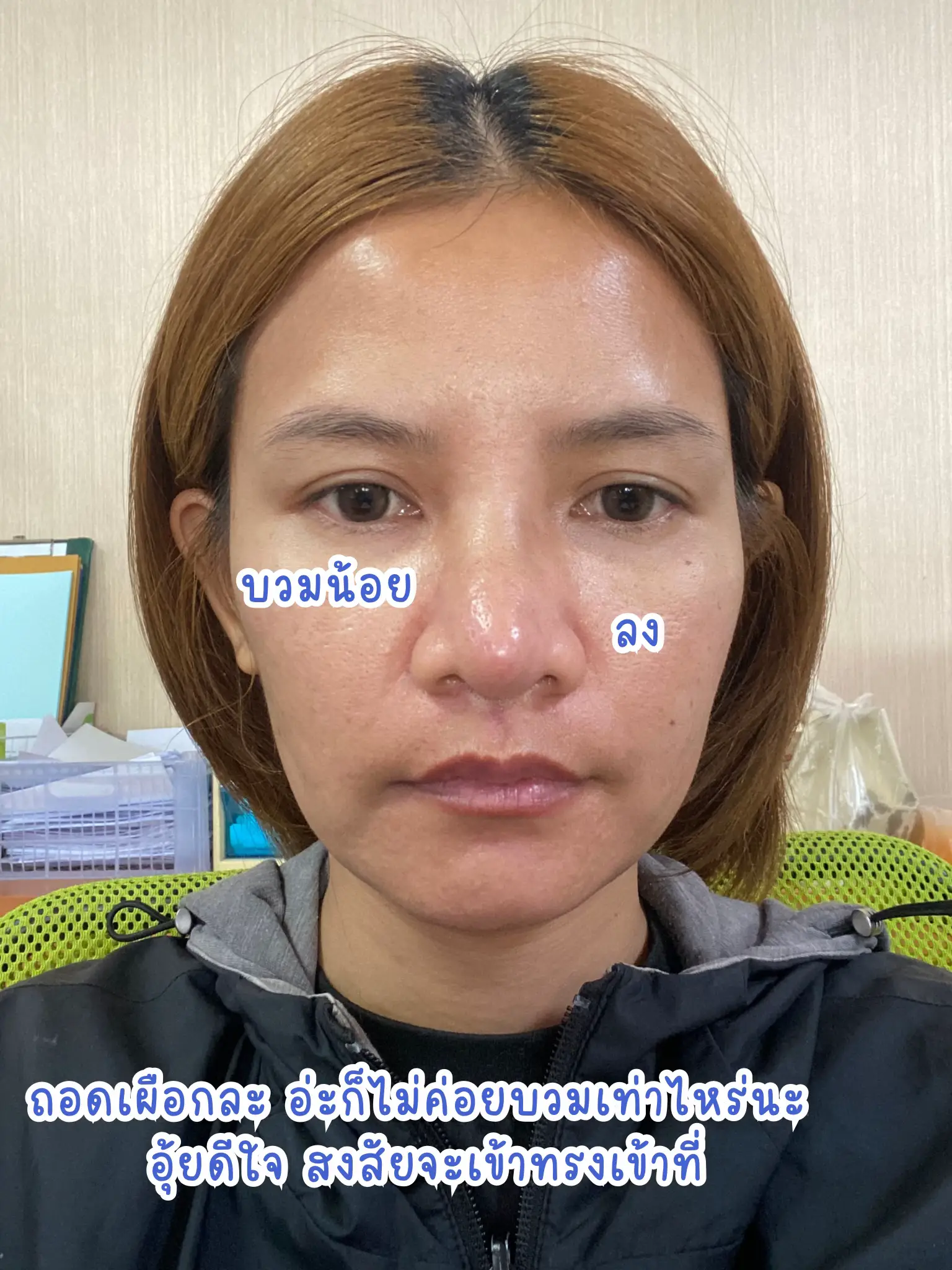 ลดบวม Proctase-P คือ ยา แก้ อะไร - การค้นหาใน Lemon8