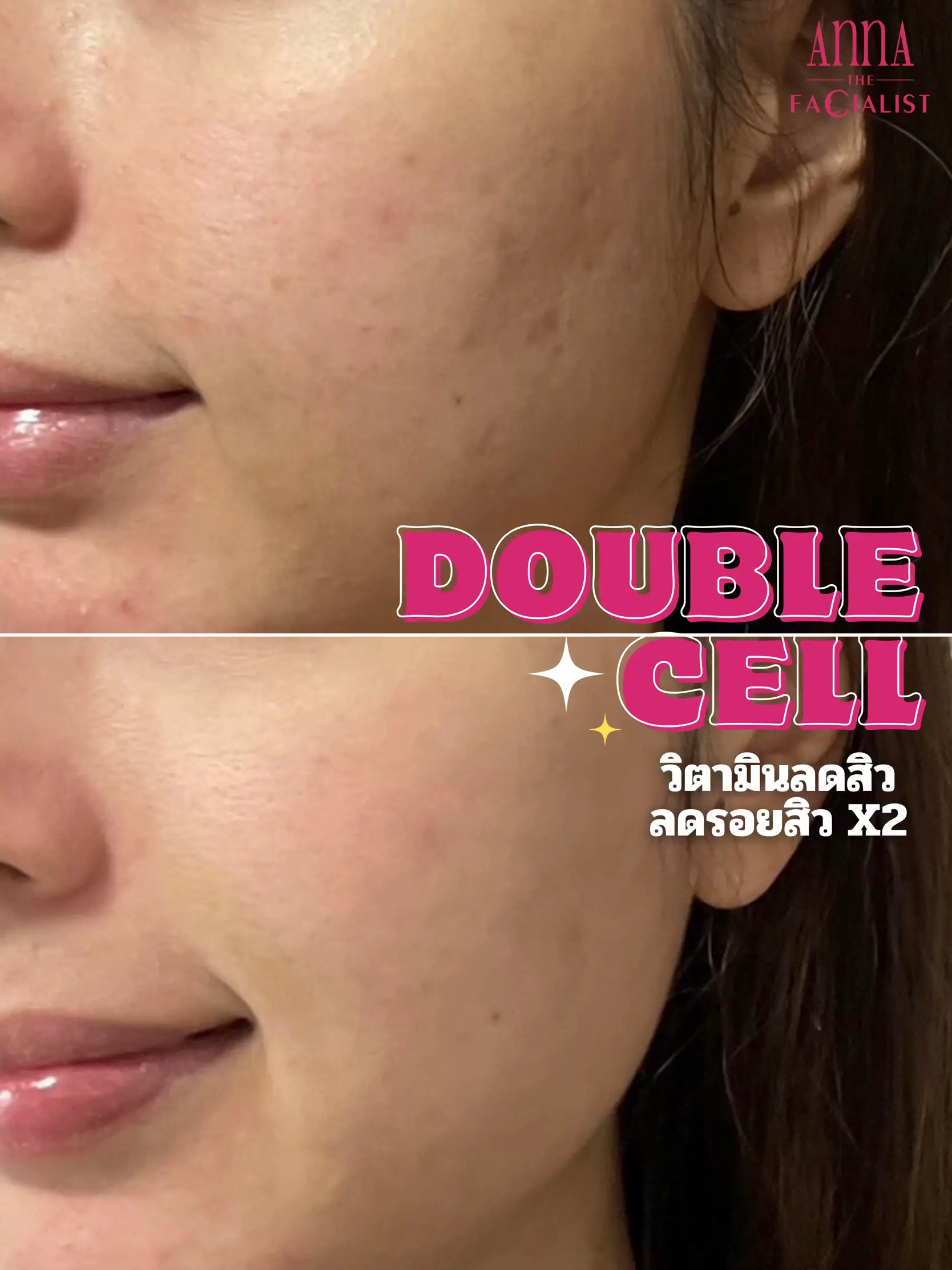 double cell วิตามินลดสิว 💖 | แกลเลอรีที่โพสต์โดย annaclinic | Lemon8