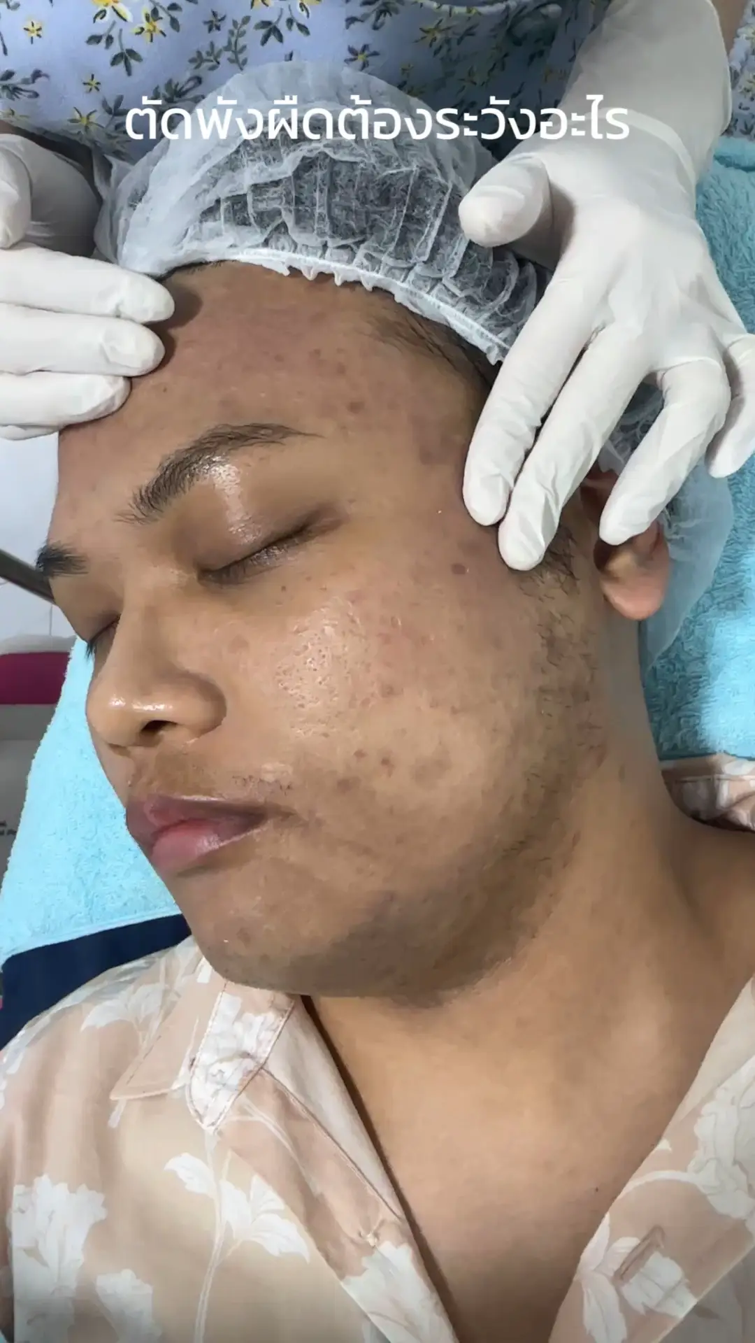 ตัดพังผืดหลุมสิวต้องระวังอะไร | วิดีโอที่เผยแพร่โดย Dr.Ploy รุ่งนภา | Lemon8