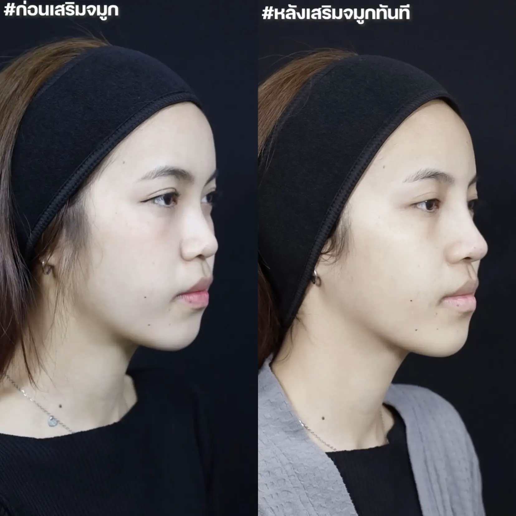 จมูกแท่งแรกในวัย20😉 | แกลเลอรีที่โพสต์โดย YEEN | Lemon8