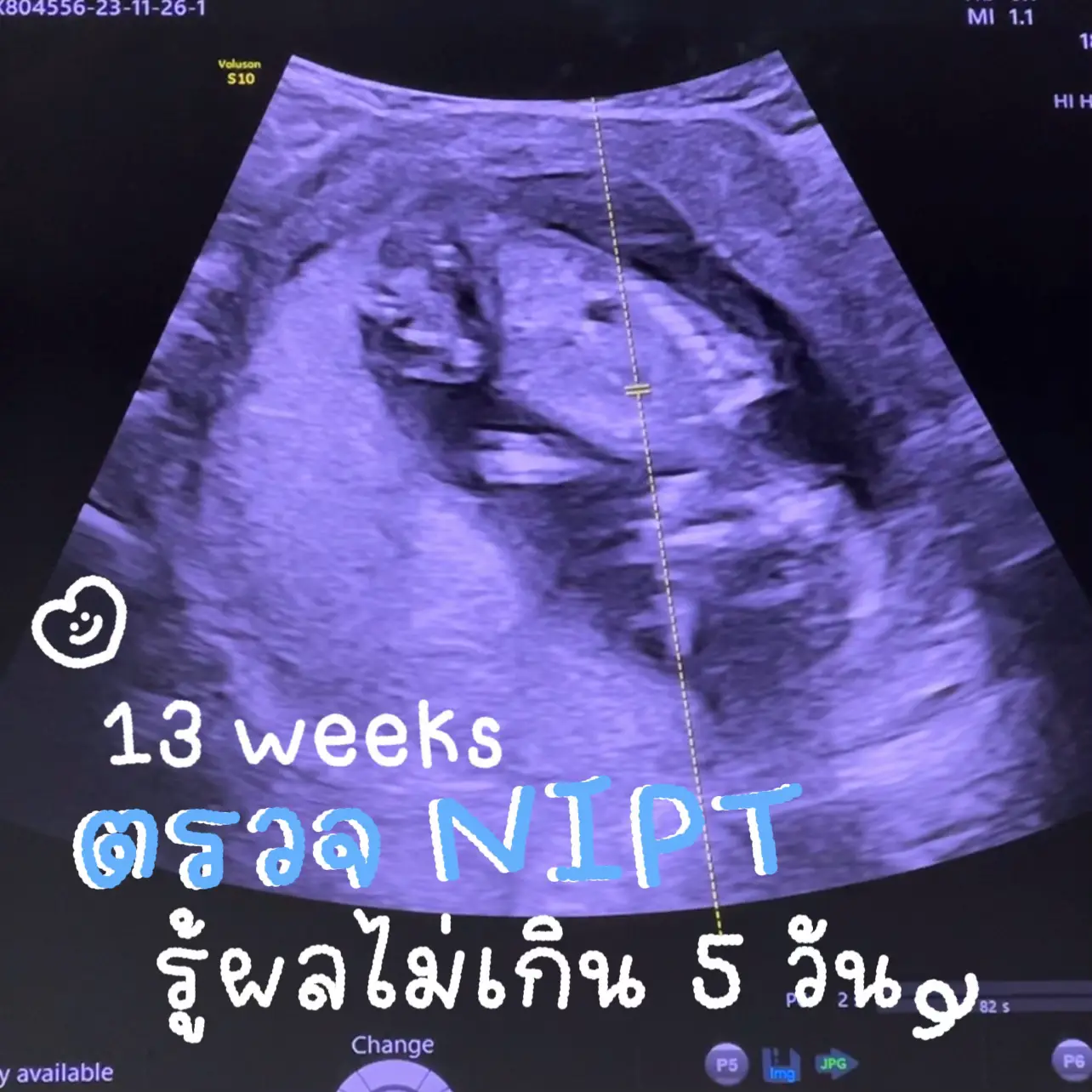 ตรวจ NIPT รู้ผลไม่เกิน5 วัน ราคาหมื่นต้นๆ | แกลเลอรีที่โพสต์โดย Lookvarsweet | Lemon8