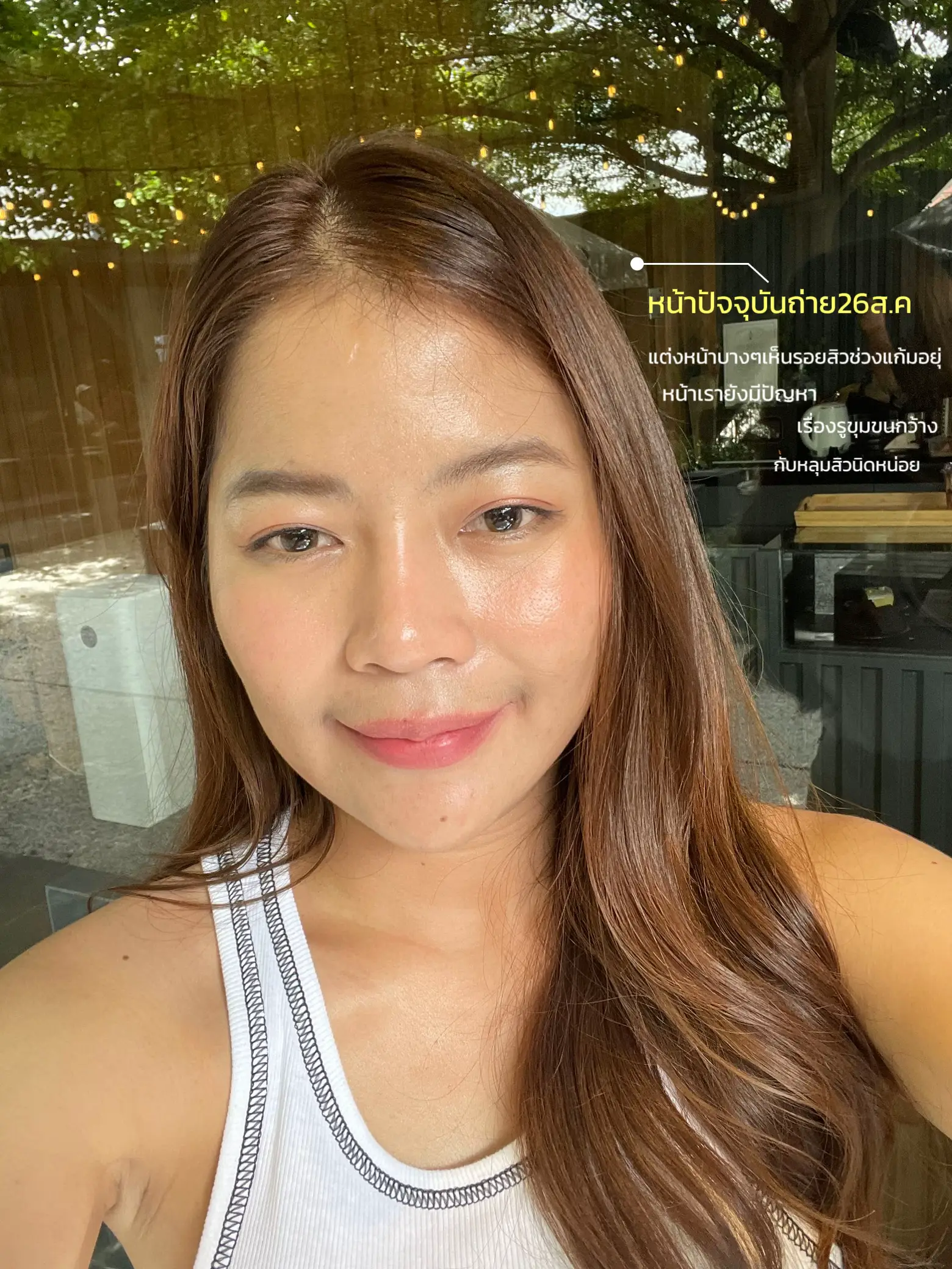 รีวิว รักษาสิวอุดตันที่พรเกษมคลินิก 1เดือน | แกลเลอรีที่โพสต์โดย Nok Ratchanok | Lemon8