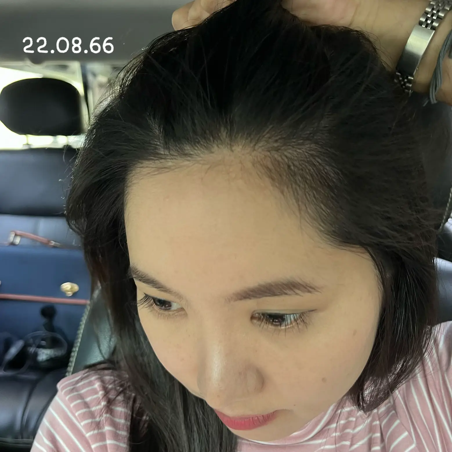 🪴รีวิวรักษาหัวล้านในวัย 33 ในราคาหลักร้อย | แกลเลอรีที่โพสต์โดย khuncha ...