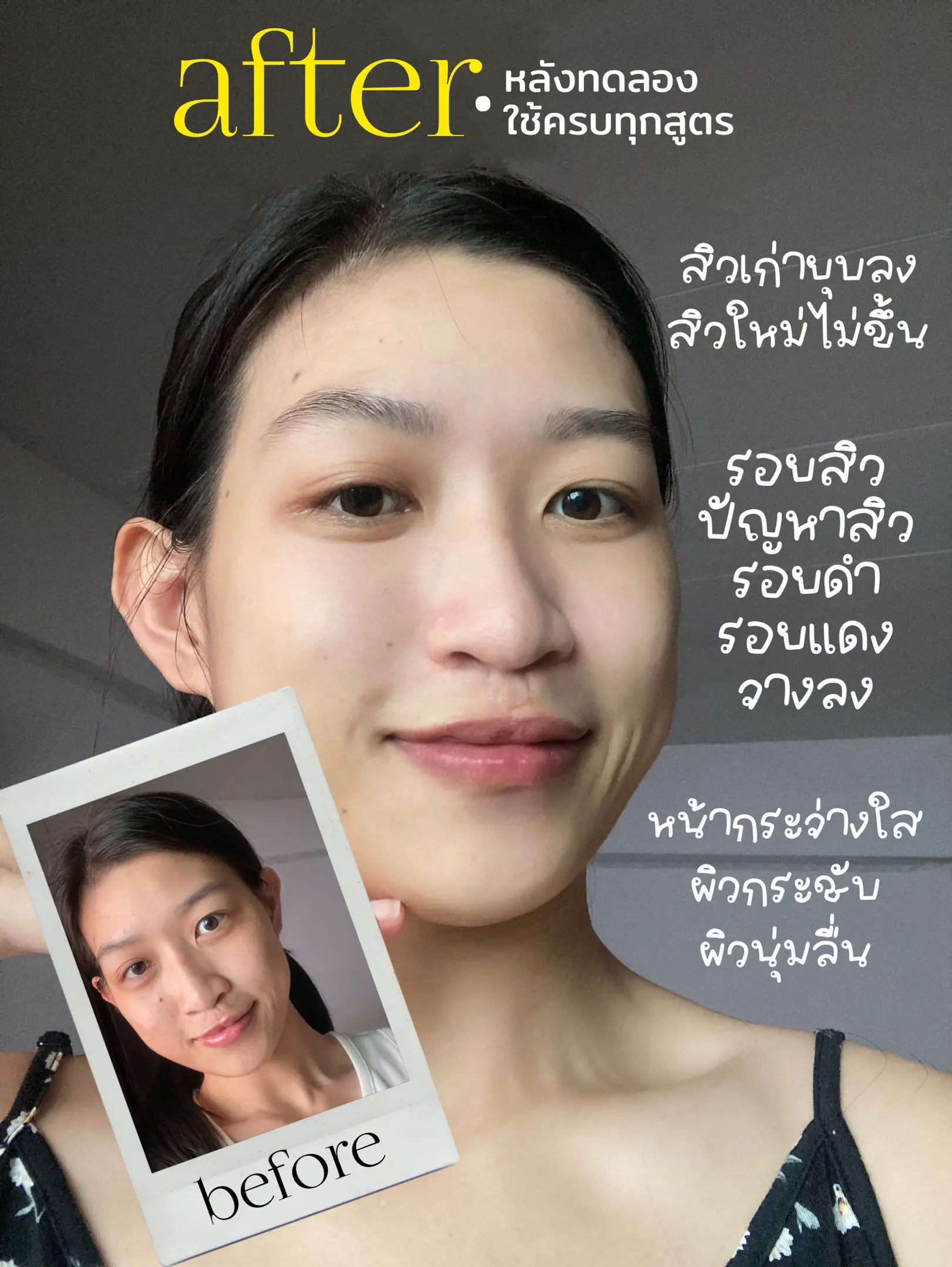 แก้ปัญหาสิวระยะยาว | Self care diary with Divyne | แกลเลอรีที่โพสต์โดย Beamthicha | Lemon8
