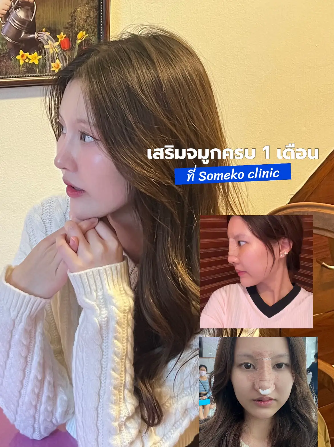 ทำจมูกครั้งแรกที่ Someko Clinic (คนทักว่าเหมือนฮันโซฮี)💭💖 | แกลเลอรีที่ ...