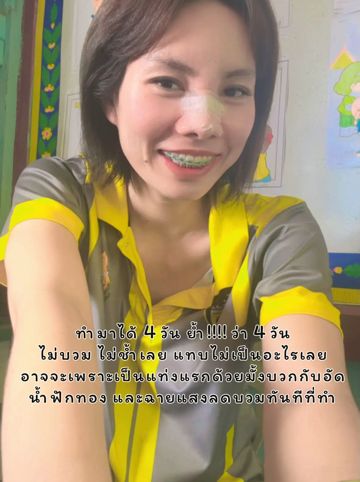 จมูก 6 เดือนแล้วเป็นยังไงบ้างมาดู | แกลเลอรีที่โพสต์โดย Kru Si | Lemon8