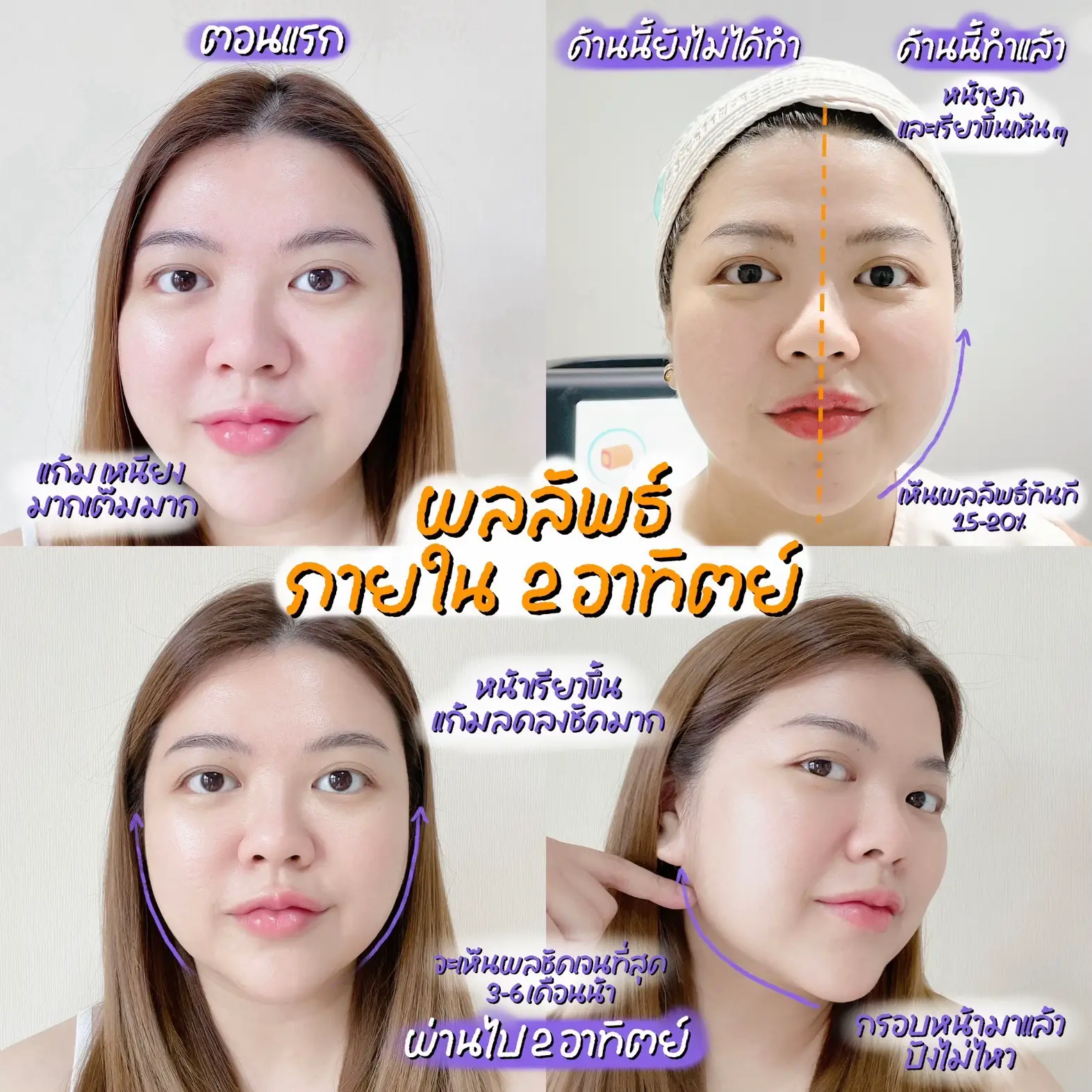หน้าบาน เหนียงเยอะ ฉีดแฟตไม่ลง ต้องจัด 𝗢𝗟𝗜𝗚𝗢 ด่วน 🇰🇷 แกลเลอรีที่โพสต์โดย รีวิวจัง 彡★ Lemon8
