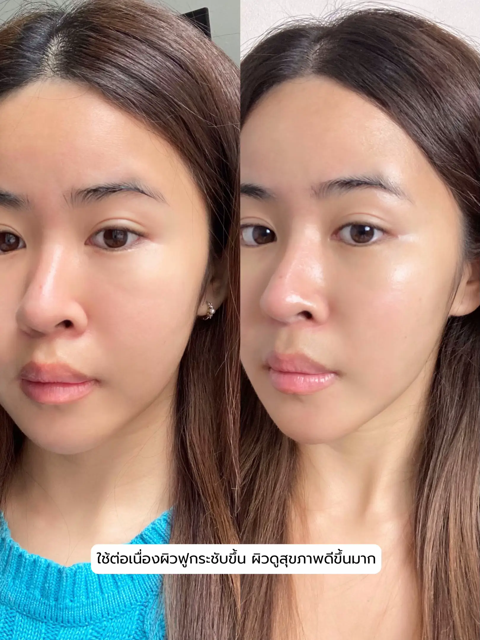 เซรั่มเข็มเปิดผิว Veedle shot มาแรงที่เกาหลี ดียังไง?เจ็บมั้ย? | แกลเลอ ...