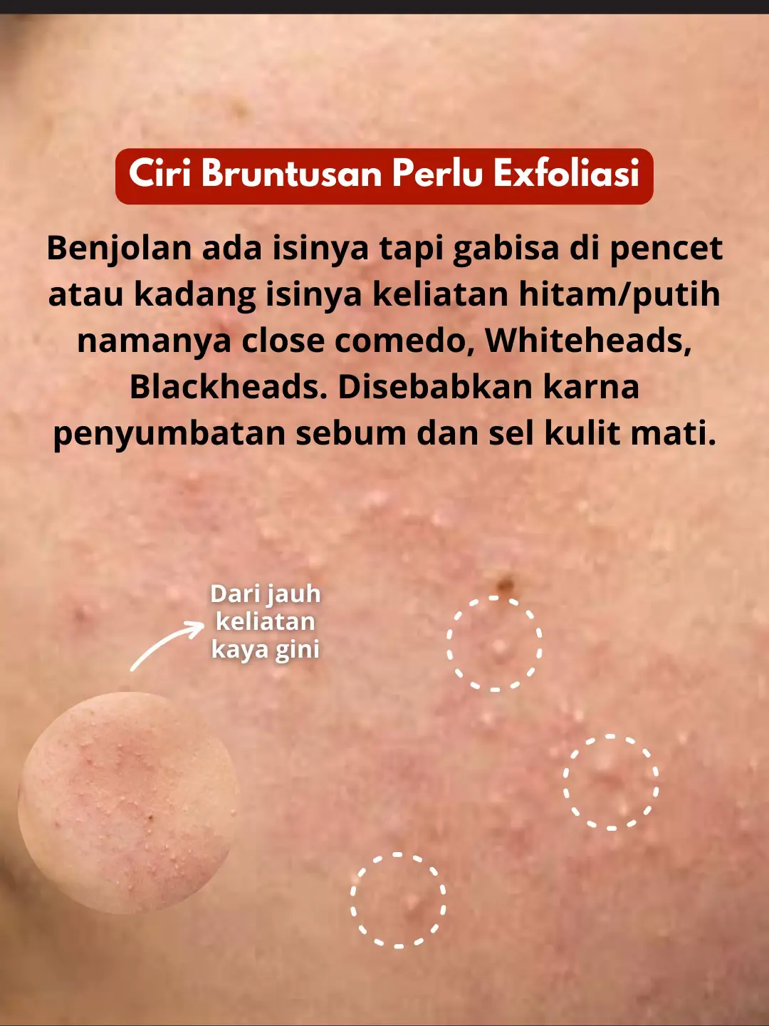 BRUNTUSAN PERLU EXFOLIASI VS HIDRASI | Galeri diposting oleh Susila | Lemon8