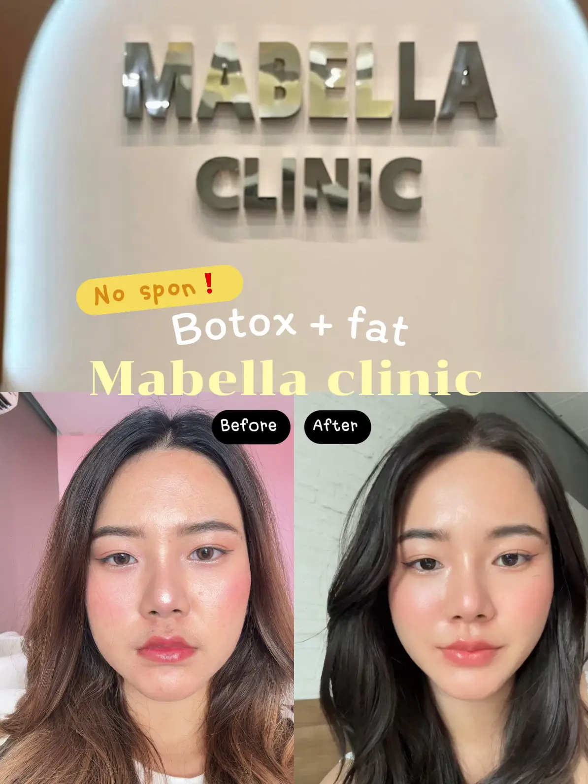 Mabella clinic ป้ายยาคลีนิคฉีดหน้าแบบโนสปอนน🌷 | แกลเลอรีที่โพสต์โดย ...
