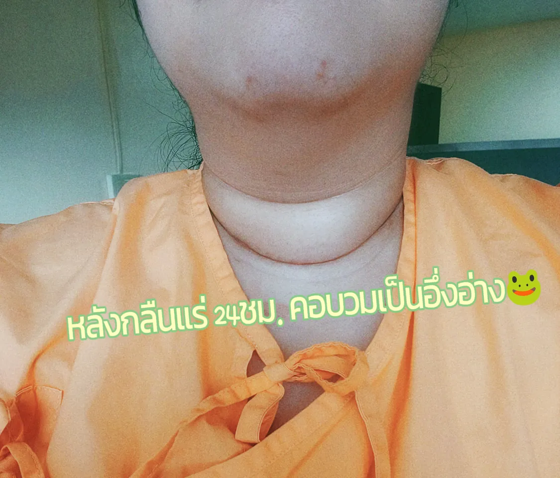 ลดบวม Proctase-P คือ ยา แก้ อะไร - การค้นหาใน Lemon8